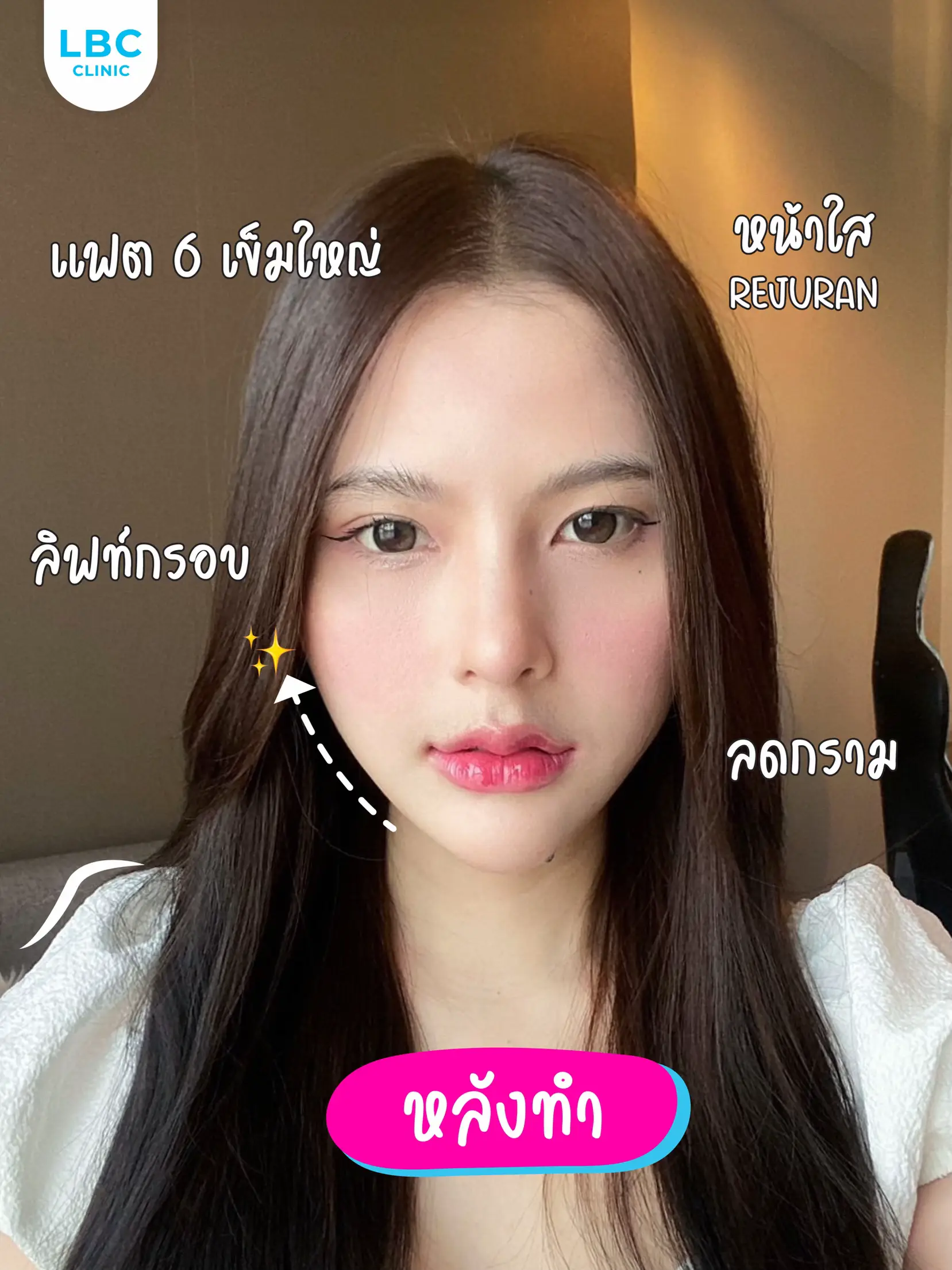 botoxกราม lbc - การค้นหาใน Lemon8