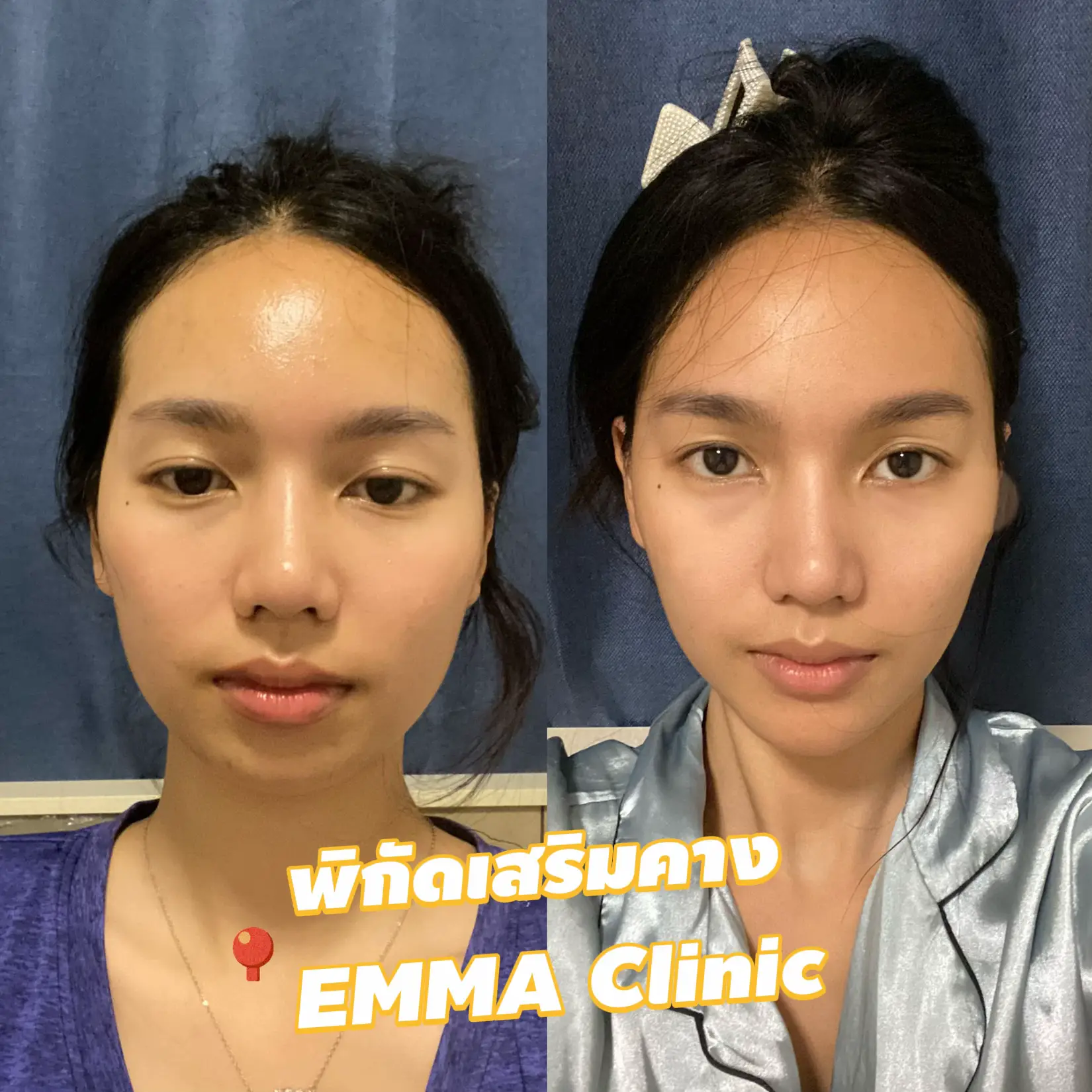 พิกัดเสริมคางEMMA Clinic | แกลเลอรีที่โพสต์โดย Aonnie | Lemon8