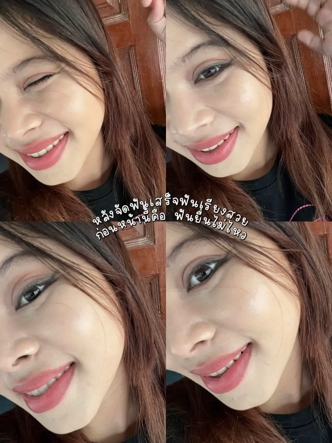 รีวิวประสบการณ์จัดฟัน ครั้งแรก | แกลเลอรีที่โพสต์โดย Chanipa Klomrak | Lemon8