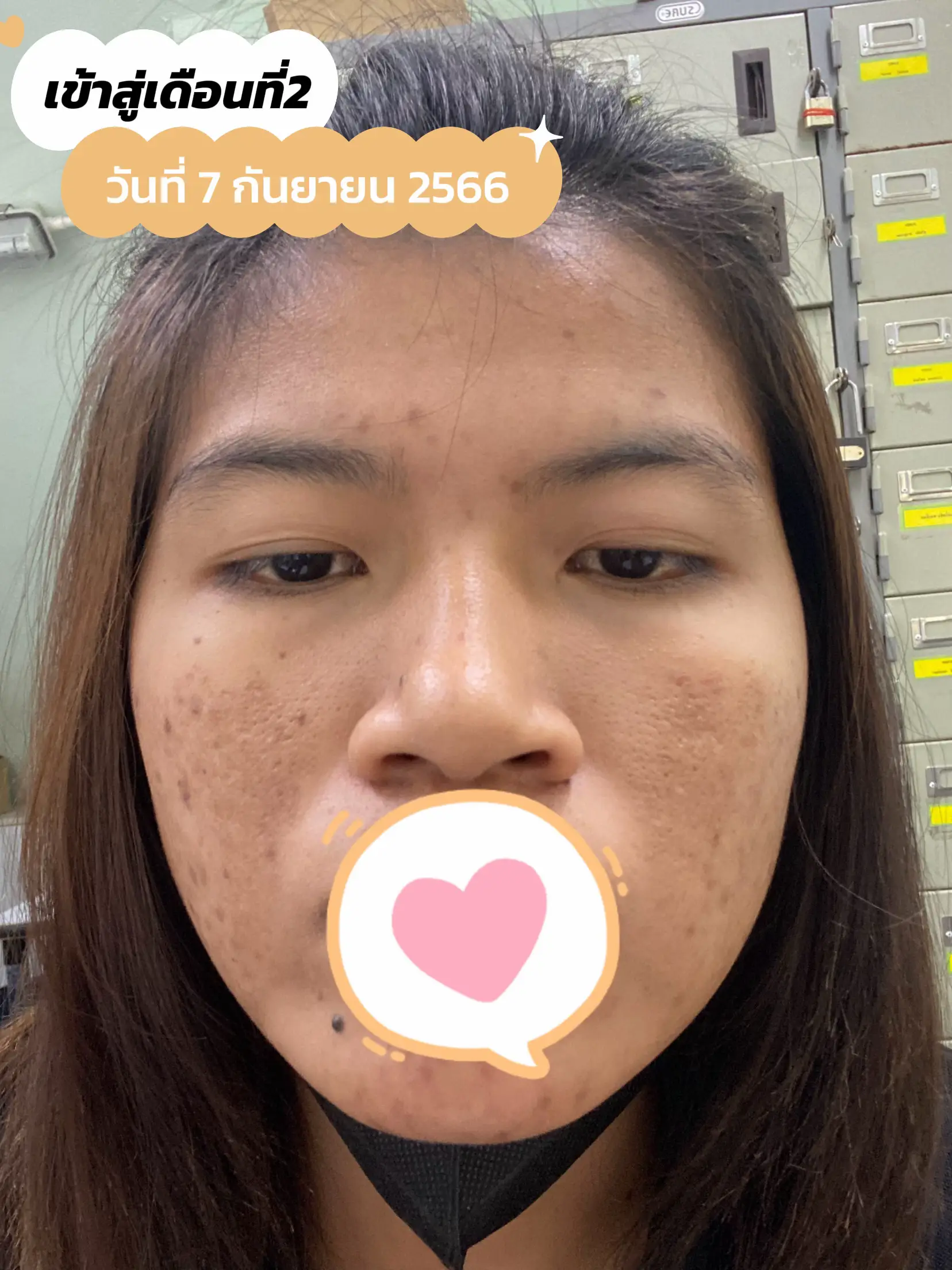 รีวิว รักษาสิวหมอวชิระ | แกลเลอรีที่โพสต์โดย Maneerat Tongta | Lemon8