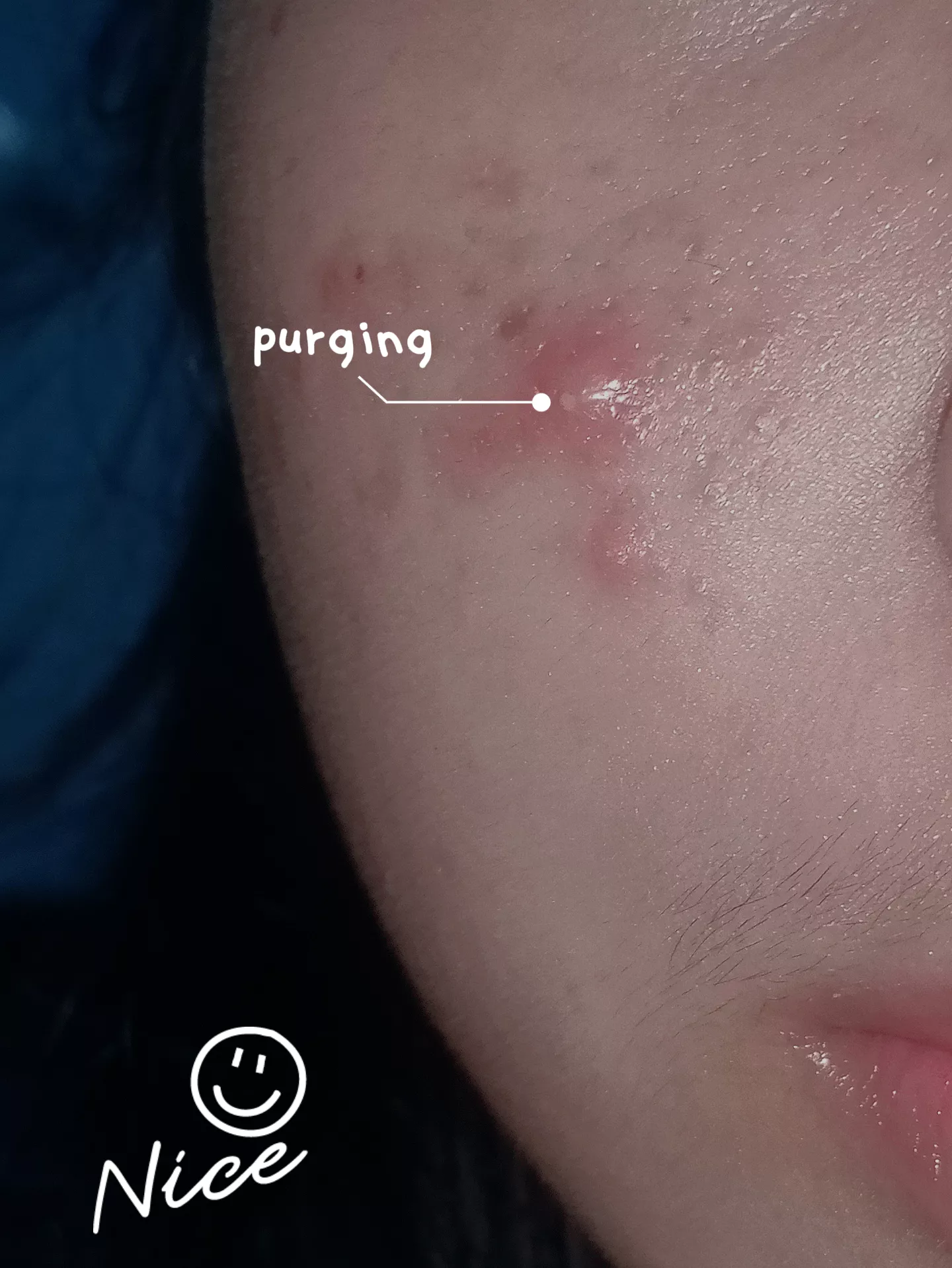 19 ide cara mengatasi komedo tertutup teratas di 2024