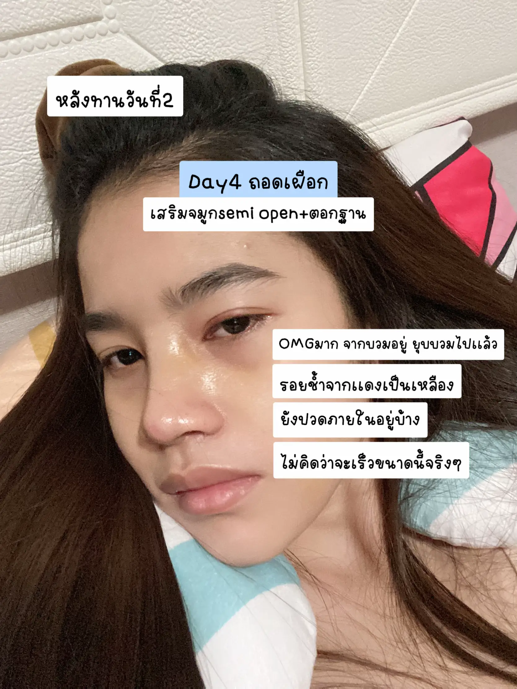 ลดบวม Proctase-P คือ ยา แก้ อะไร - การค้นหาใน Lemon8