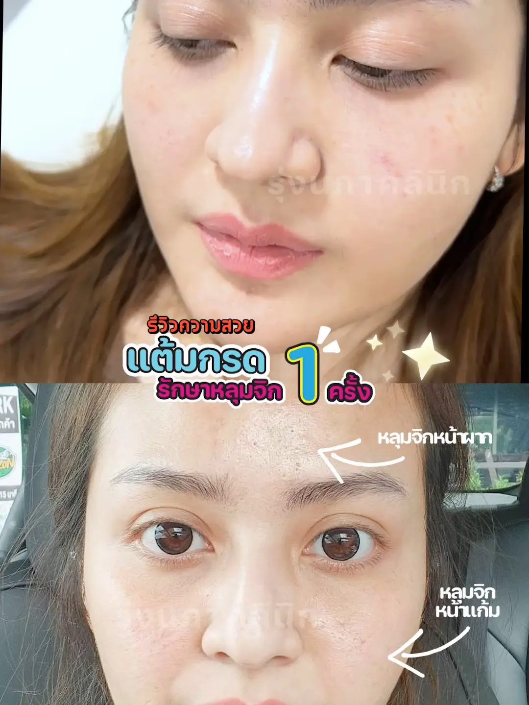 รักษาหลุมสิว แค่แต้มกรดไป 1 ครั้ง 😍 | วิดีโอที่เผยแพร่โดย Dr.Ploy รุ่งนภา | Lemon8