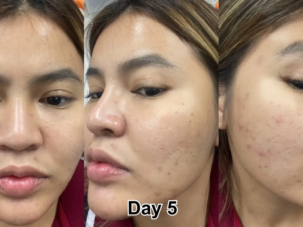 perfect clear anti acne booster | แกลเลอรีที่โพสต์โดย Chontiros_d | Lemon8