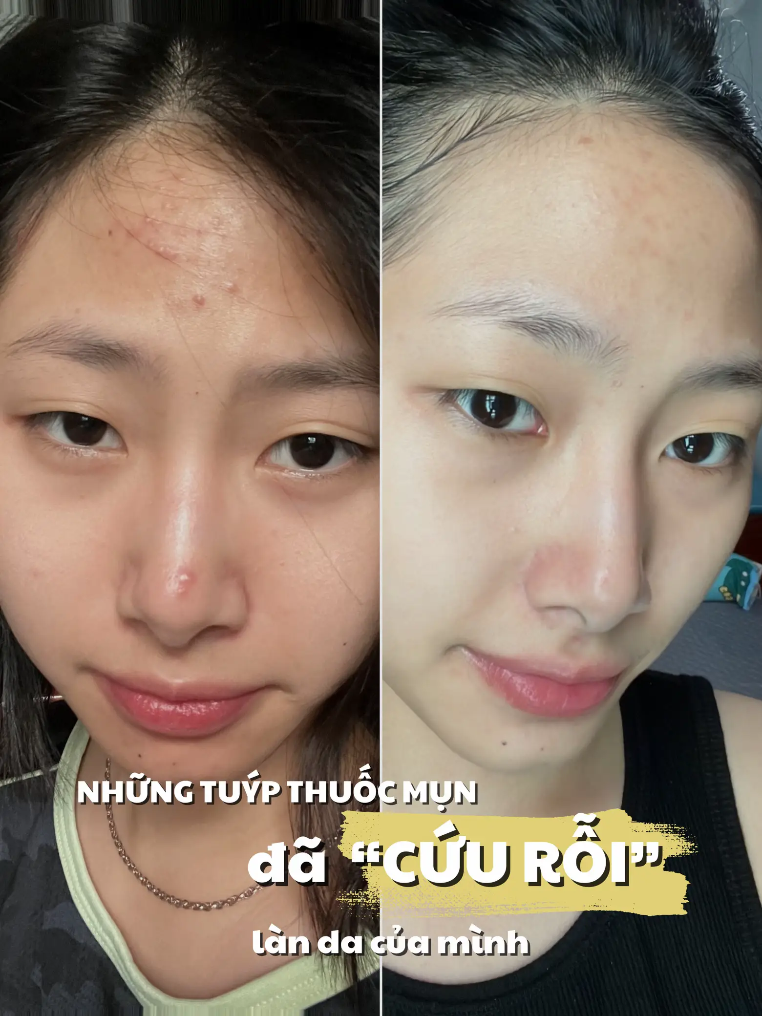 NHỮNG TUÝP THUỐC MỤN ĐÃ "CỨU RỖI" LÀN DA CỦA MÌNH | Bộ sưu tập do Pham Ha My đăng | Lemon8