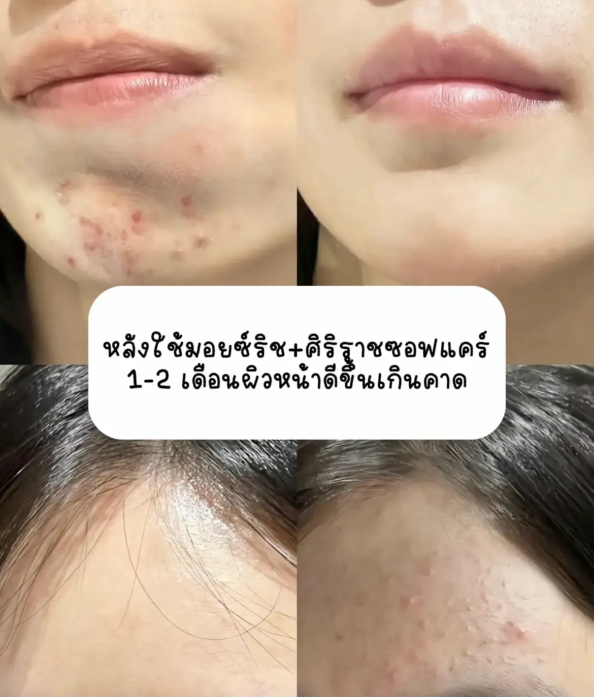 หลังใช้มอยซ์ริช+ศิริราชซอฟแคร์1-2 เดือนผิวหน้าดีขึ้นเกินคาด | แกลเลอรีที่โพสต์โดย 𝓜𝓪𝔂𝔃𝓪♡ | Lemon8