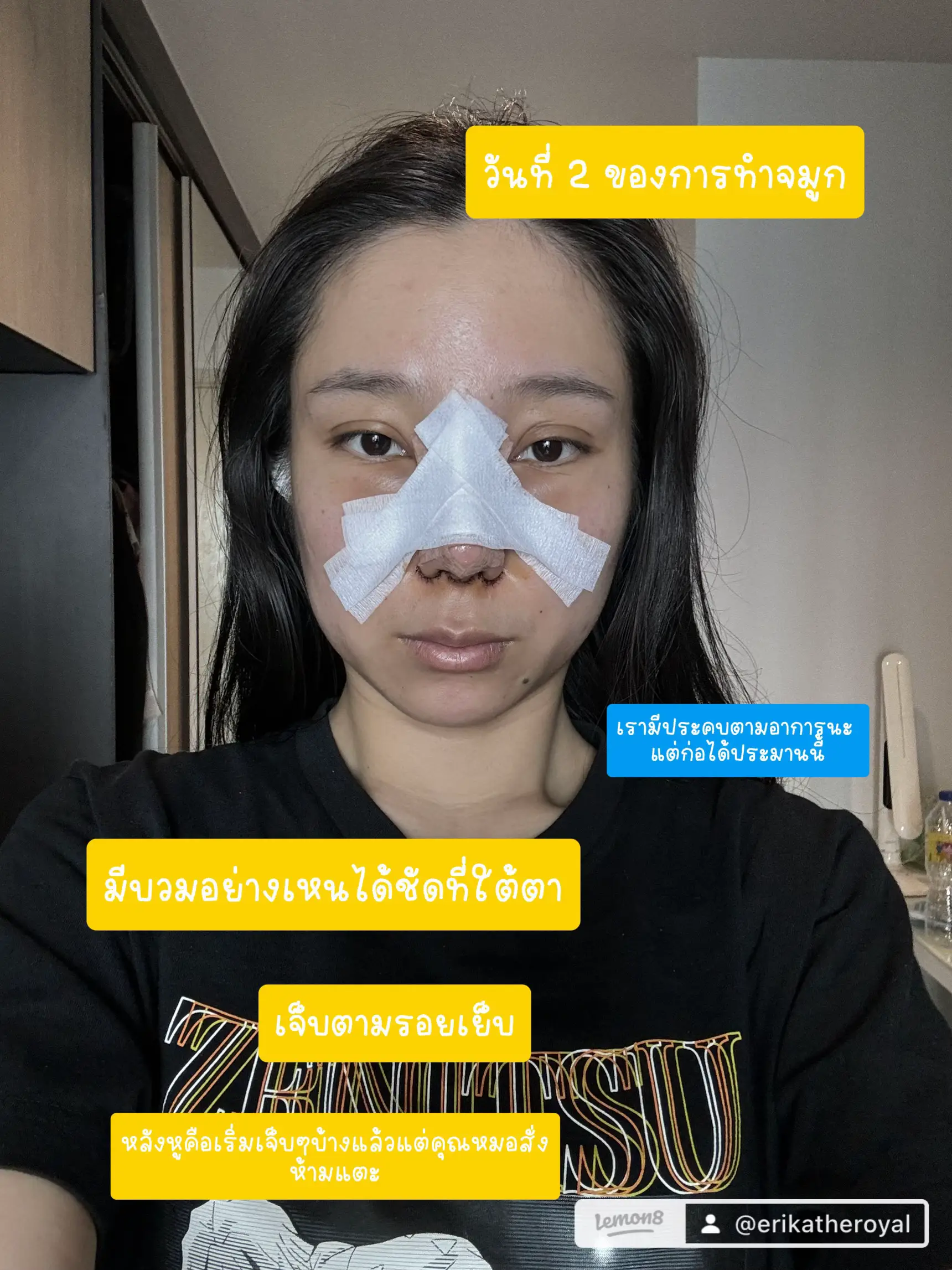 พรีชีพ ครั้งแรก เสริมจมูก full open+กระดูกหลังหู no spon | แกลเลอรีที่ ...