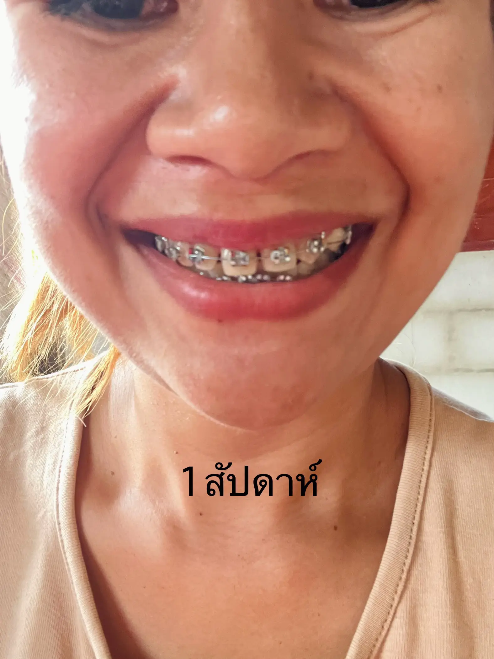 มาแชร์ประสบการจัดฟัน | แกลเลอรีที่โพสต์โดย Maprang Jantima | Lemon8