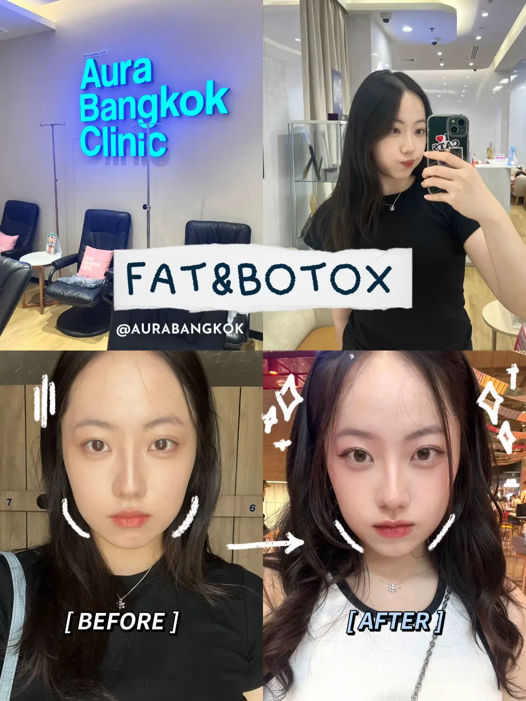 ฉีด fat + botox ครั้งแรก! | แกลเลอรีที่โพสต์โดย Cake Liyuan | Lemon8