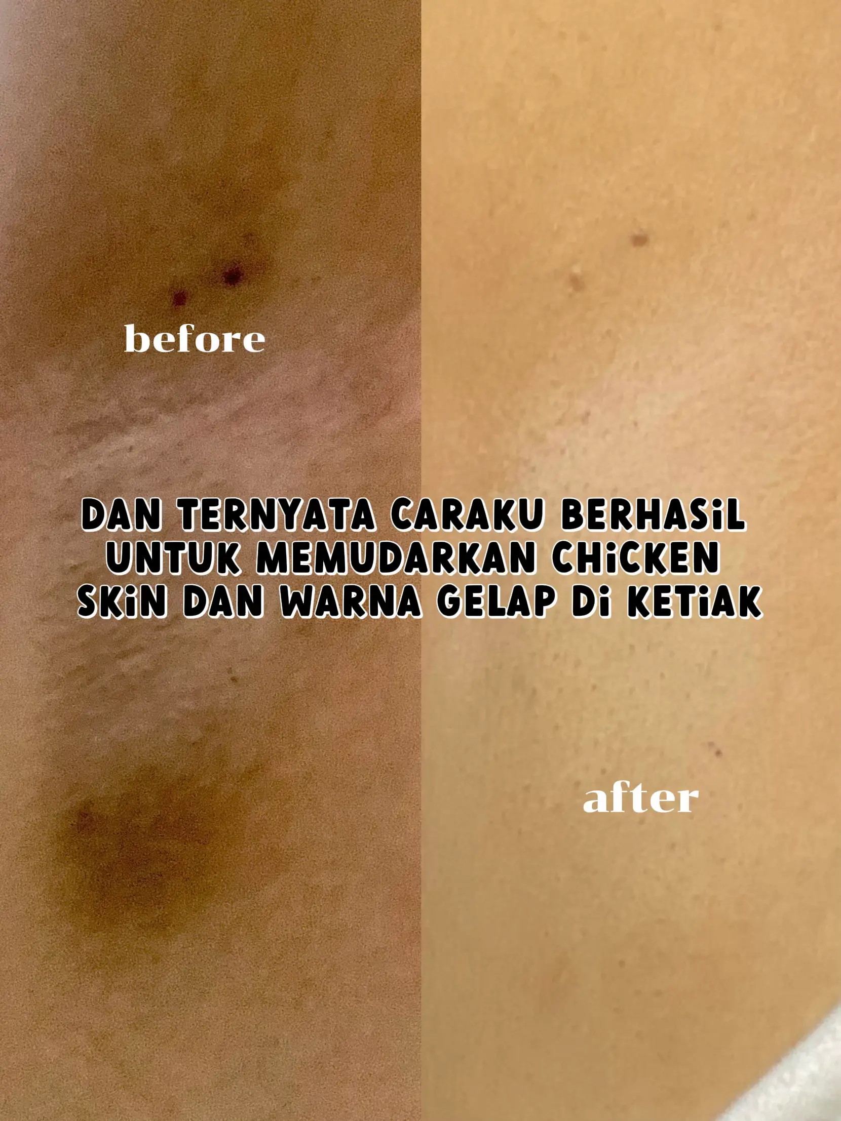 Kebiasaan yang memicu chicken skin‼️ | Galeri diposting oleh dmly 🕊️ ...