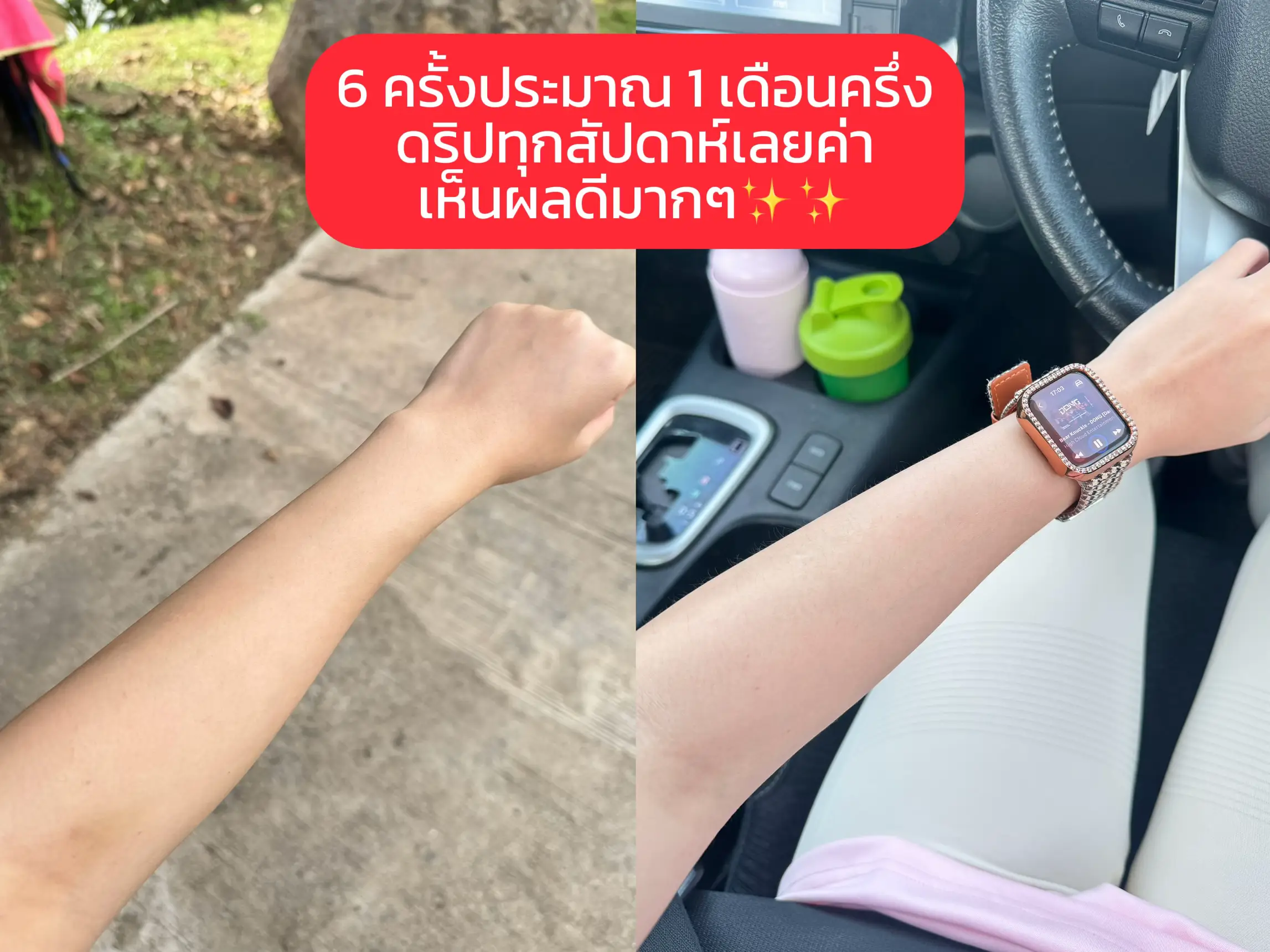 ดริปผิว 6 ครั้ง💉 ผิวดีขึ้นจริงไหม ? 👀 | แกลเลอรีที่โพสต์โดย ssompns | Lemon8