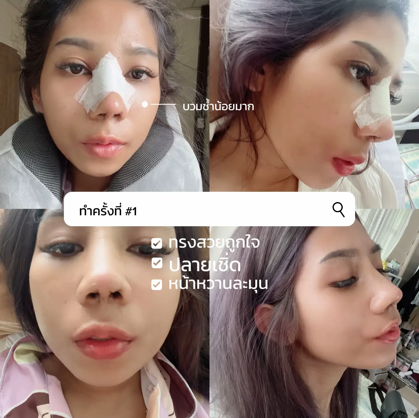 แก้จมูกครั้งที่ 3 ! 🍋 | แกลเลอรีที่โพสต์โดย DOUBLE D ; ♡ 94 | Lemon8