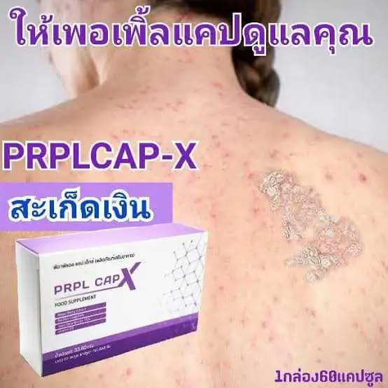 สะเก็ดเงิน Pantip - การค้นหาใน Lemon8