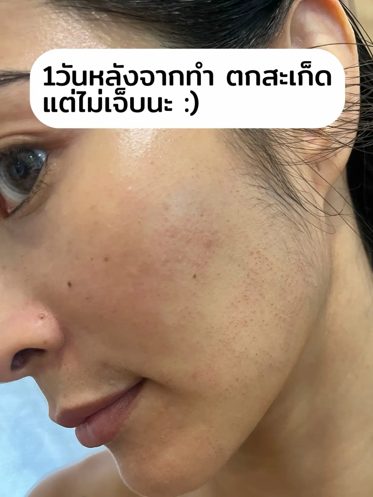 ลองนวัตกรรมล่าสุด สร้างเซลล์ผิวใหม่ให้อิ่มฟูดูเด็กลงด้วย SMPF | แกลเลอรีที่โพสต์โดย Nae ...