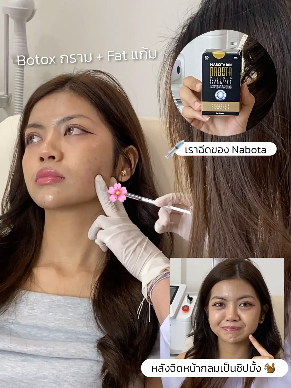 วงการฉีดหน้าเข้าแล้วออกยากสุดๆ | Botox+Fat💉👀 | แกลเลอรีที่โพสต์โดย Kkacha | Lemon8