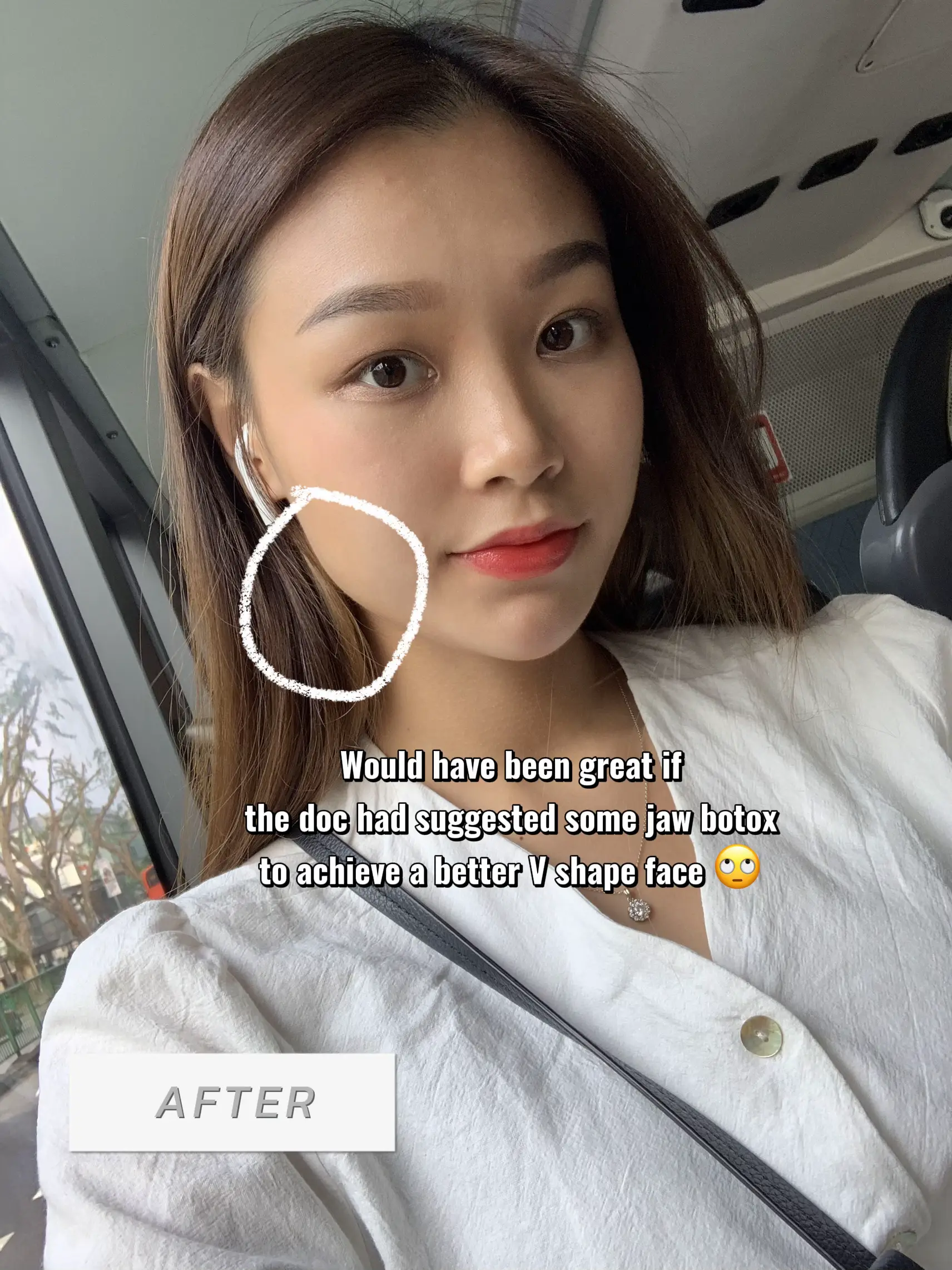 My first filler experience back in 2019 ☝🏻 | Gallery posted by ...