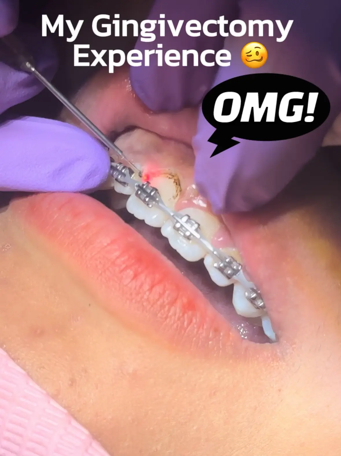 My Gingivectomy Experience 🥴 | Galeri disiarkan oleh putri khaleda | Lemon8