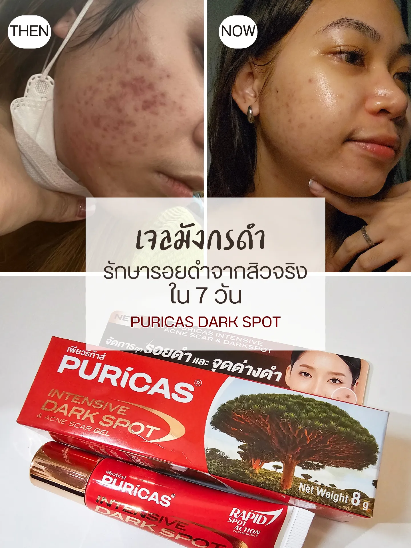 รอยแผลสิว กวนใจนัก ทำยังไงถึงจะหาย? | วิดีโอที่เผยแพร่โดย Yuinsoul.bt | Lemon8