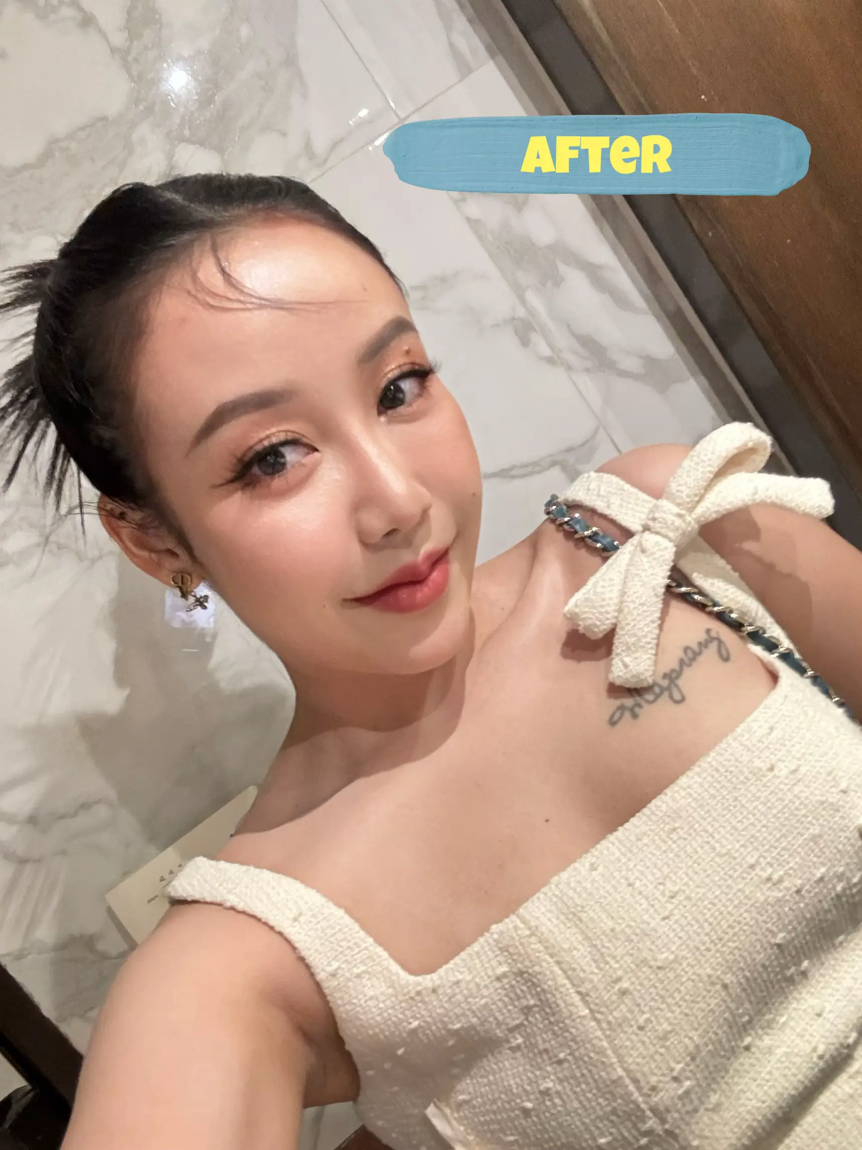 Filler แค่ 8cc เปลี่ยนหน้าฉัน!! | แกลเลอรีที่โพสต์โดย หาเรื่องเสียตัง | Lemon8