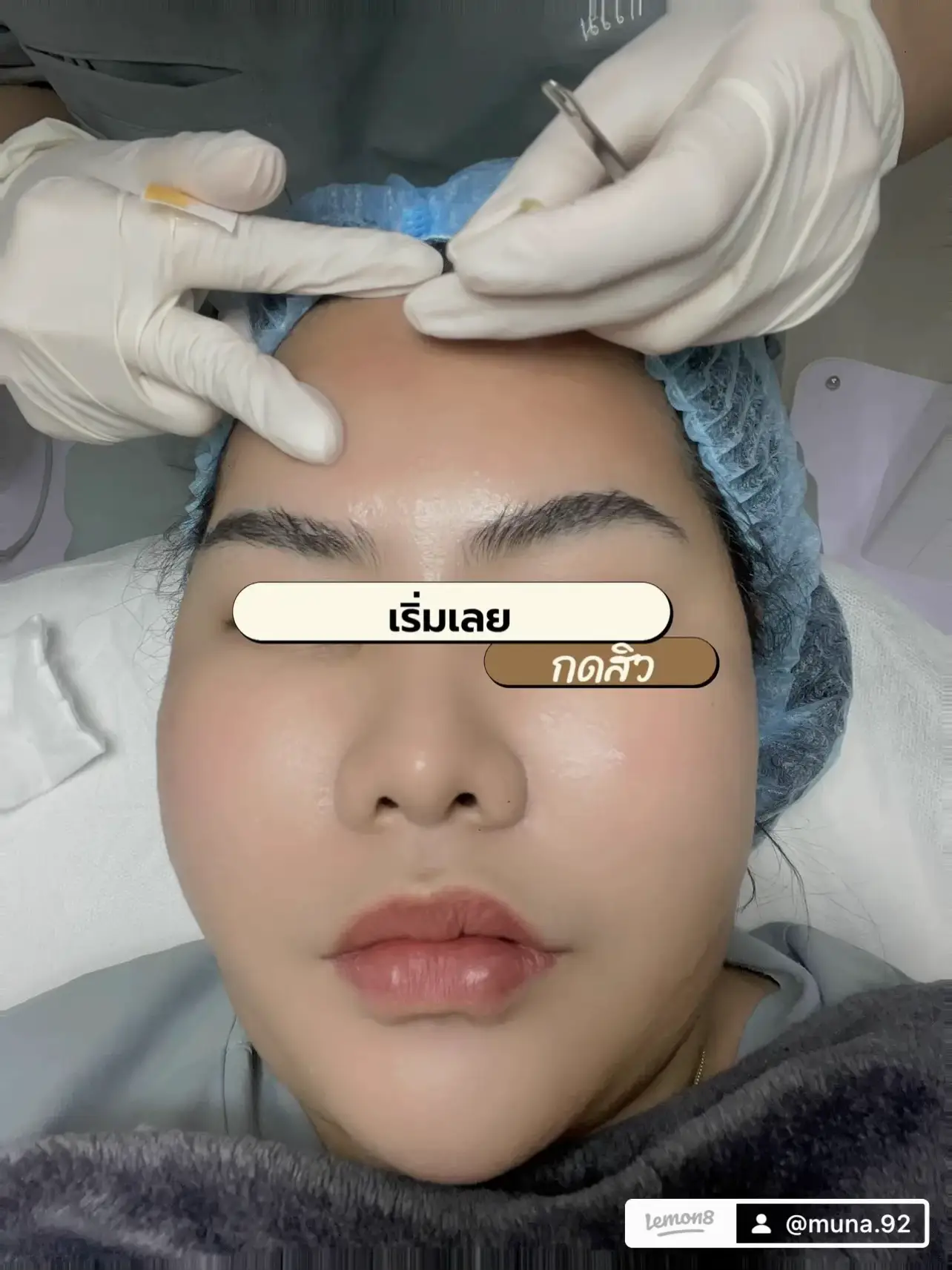 รักษาสิวแบบ 4ขั้นตอน | แกลเลอรีที่โพสต์โดย MUNA | Lemon8