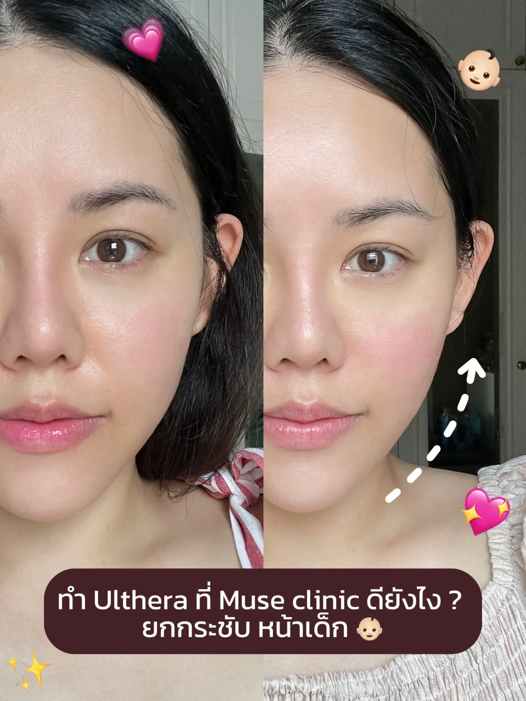 ทำ Ulthera ที่ Muse clinic ดียังไง ? ยกกระชับ หน้าเด็ก 👶🏻 | แกลเลอรีที่โพสต์โดย Hello muse 🪄 ...
