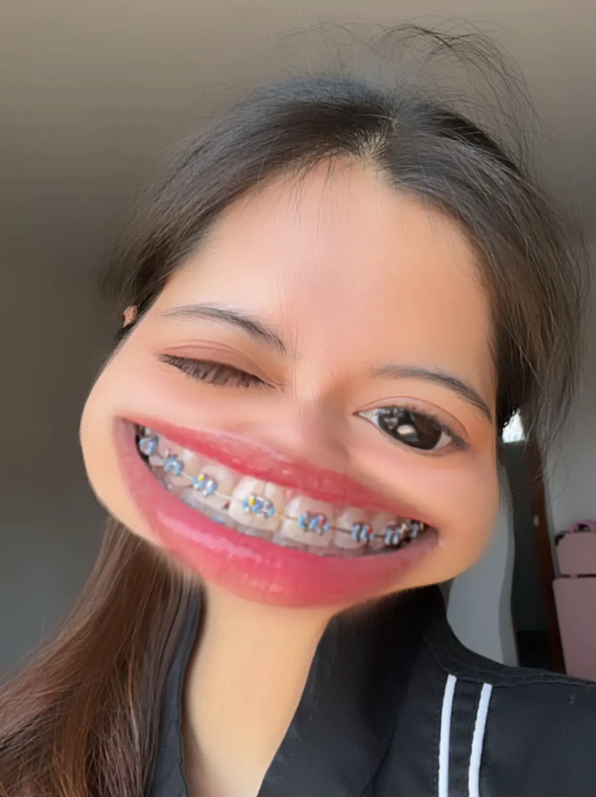 Braces color review, blue-gray🩵 | Gallery posted by manaw | Lemon8