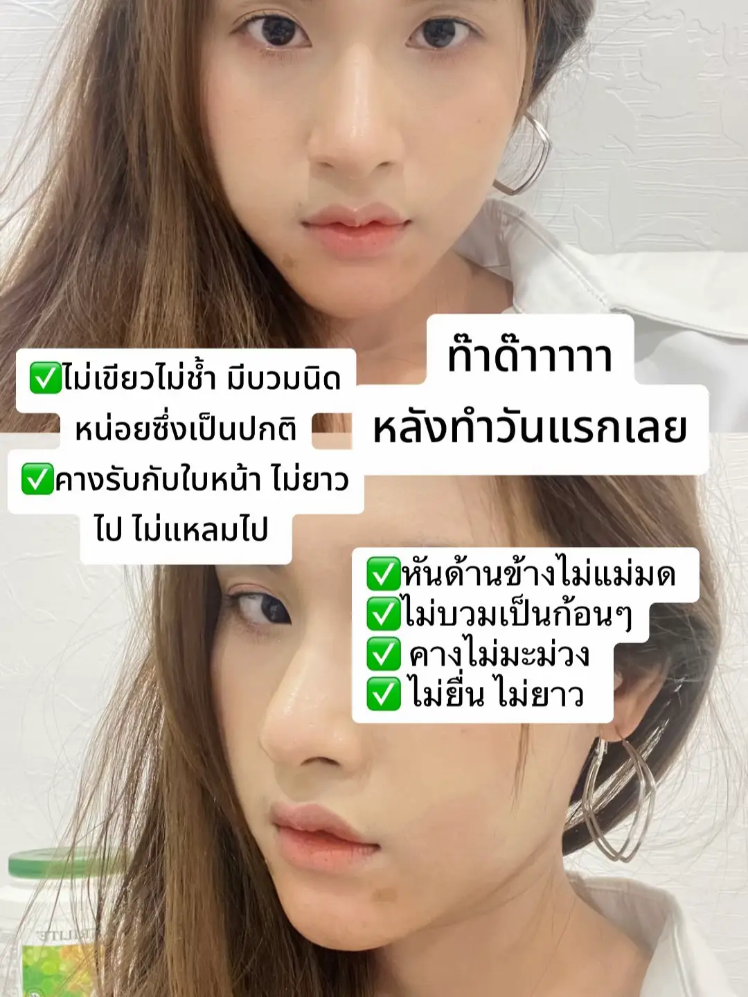 แนะนำาดูก่อนไปฉีดฟิลเลอร์คาง | แกลเลอรีที่โพสต์โดย Donlaya Khotuth | Lemon8