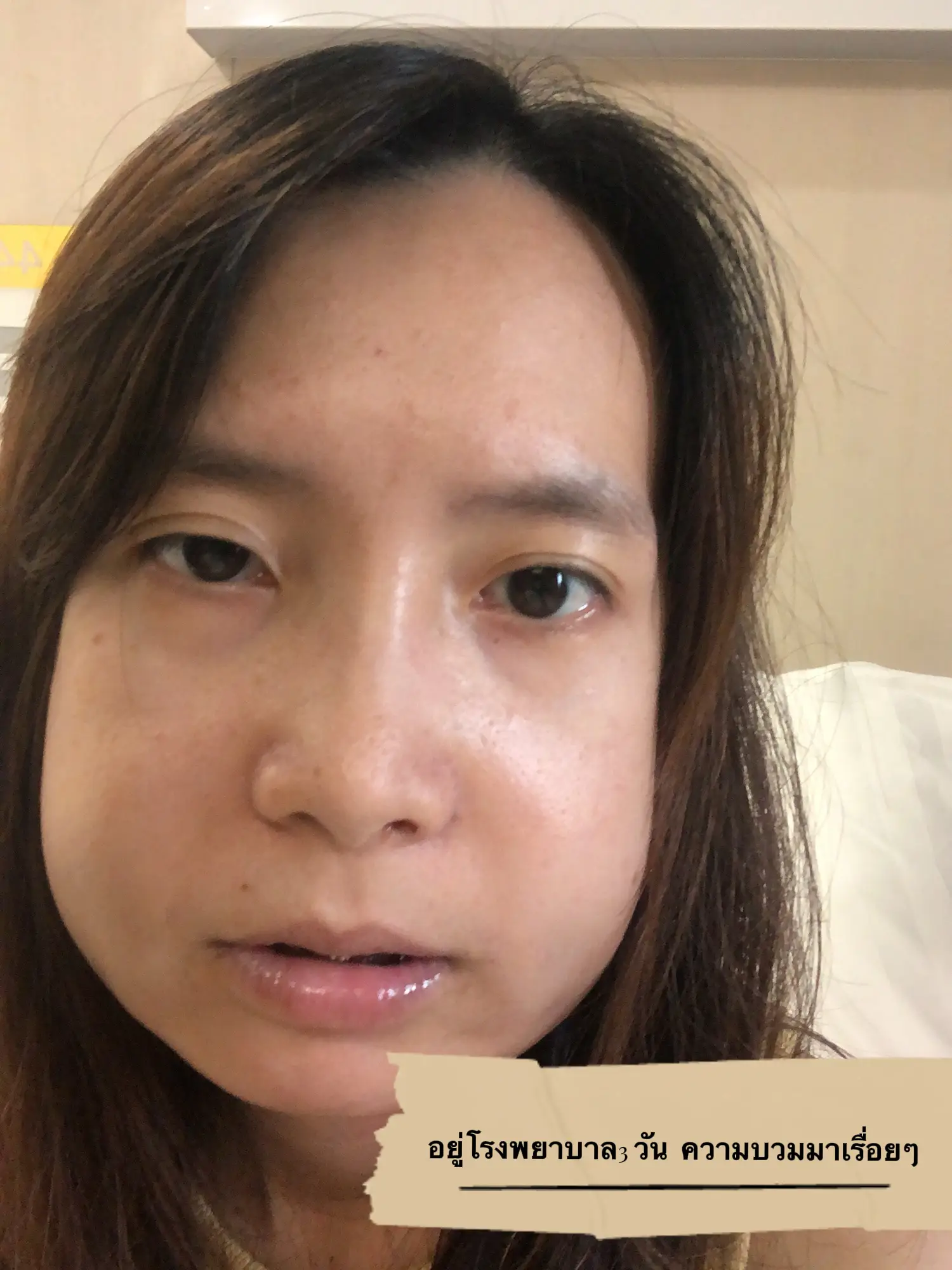 ภาคต่อ ประสบการณ์ผ่าตัดขากรรไกร 7วันแรก | แกลเลอรีที่โพสต์โดย PpSAmE | Lemon8