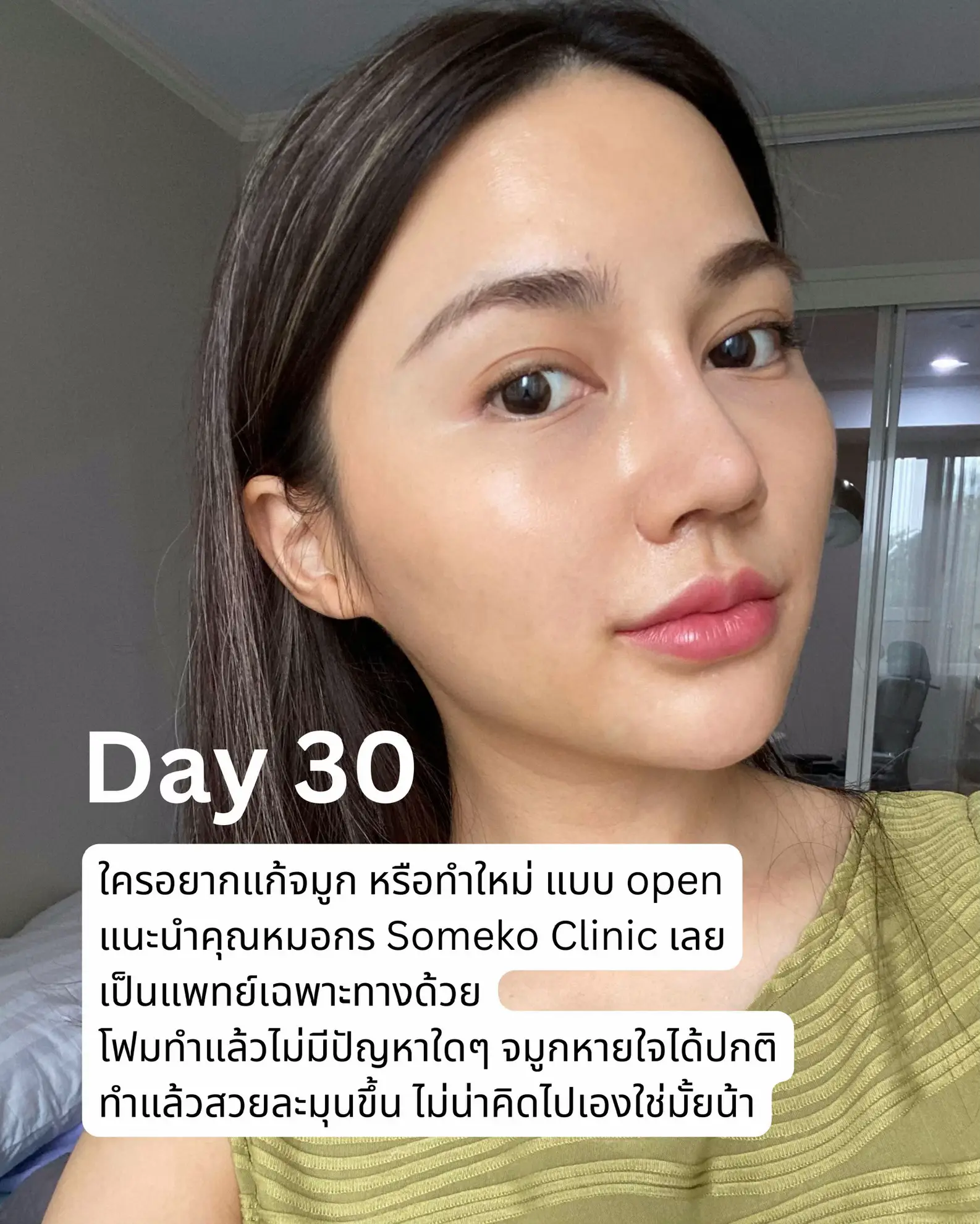 รีวิวแก้จมูก 👃🏻 ลาก่อน 8 ปีที่อยู่ด้วยกันมา 🤗 แกลเลอรีที่โพสต์โดย