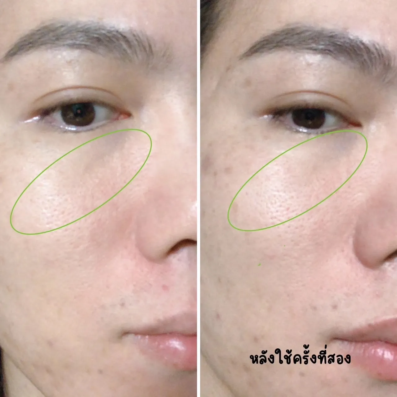 แปะ The Awesome Patch แล้วไปนอน‼️ | แกลเลอรีที่โพสต์โดย Benzsocute | Lemon8