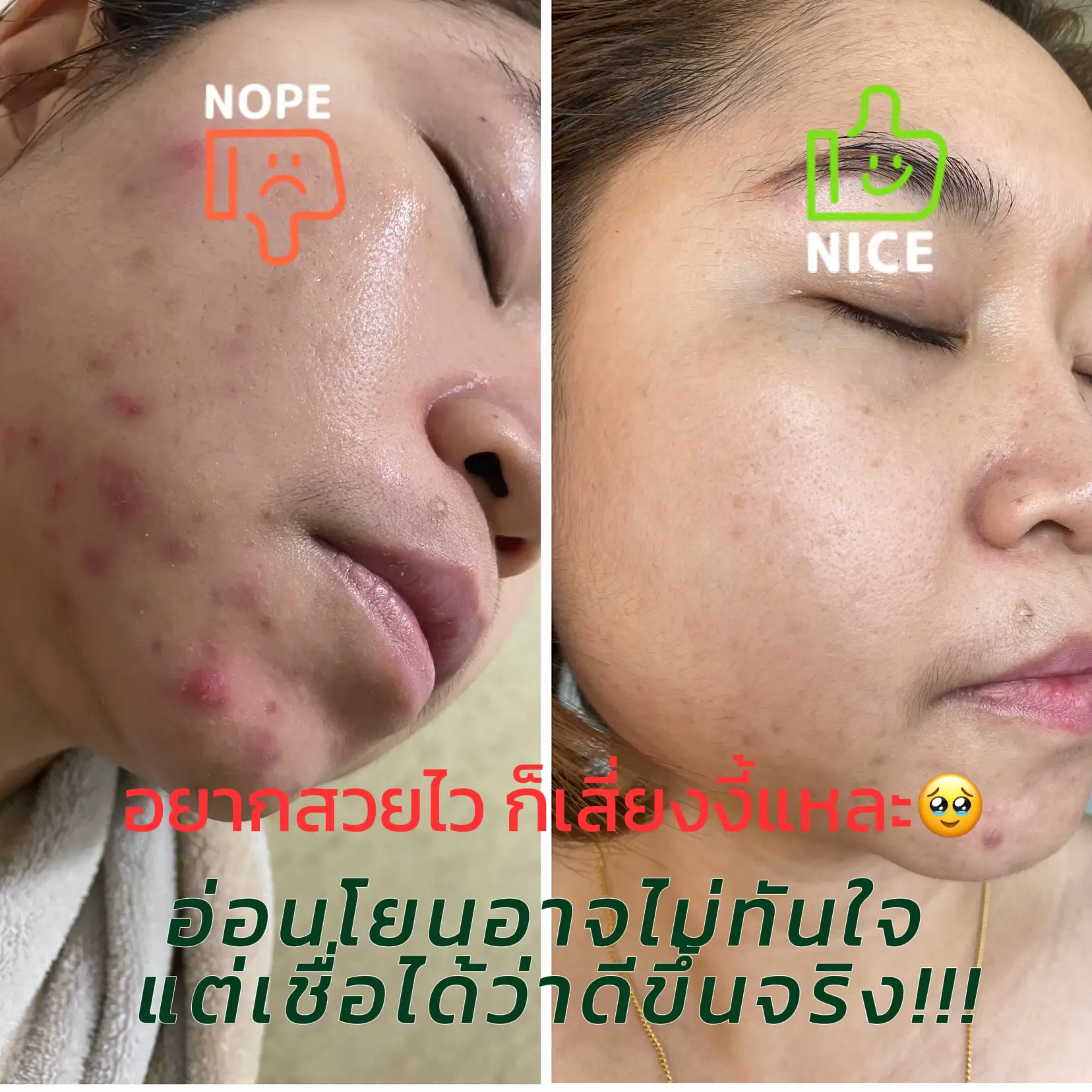 อ่อนโยนไม่ผิด ผิดที่หนังหน้าตัวเอง🫢 | แกลเลอรีที่โพสต์โดย Poly.Reen | Lemon8