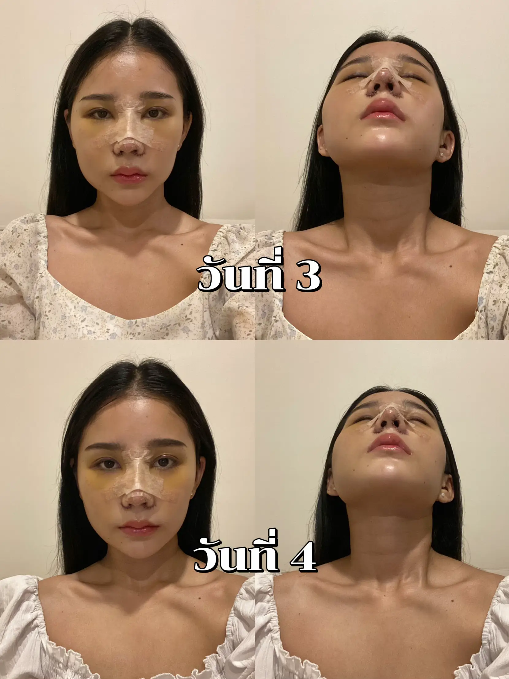 ศัลยกรรมครั้งแรกในชีวิต ปังหรือพัง ‼️ | แกลเลอรีที่โพสต์โดย Nu Dee🐰 | Lemon8