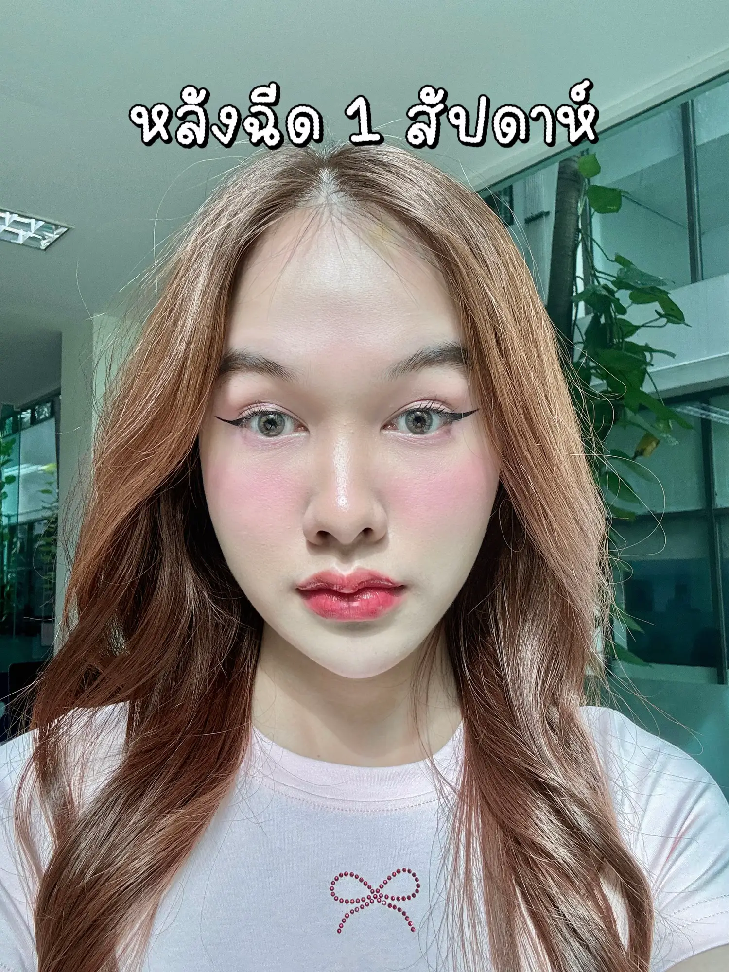 รีวิวโบริ้วรอยรอบที่ 2 ในวัย 23 ปี! | แกลเลอรีที่โพสต์โดย Yean | Lemon8