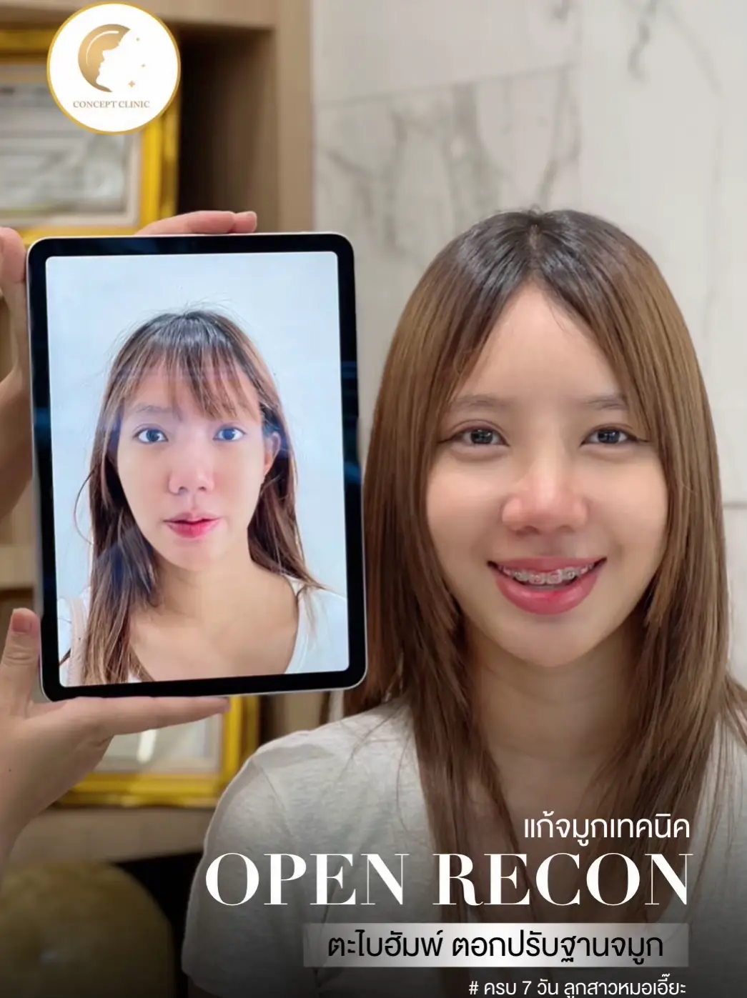 รีวิวแก้จมูกโอเพ่น | แกลเลอรีที่โพสต์โดย Conceptclinic | Lemon8