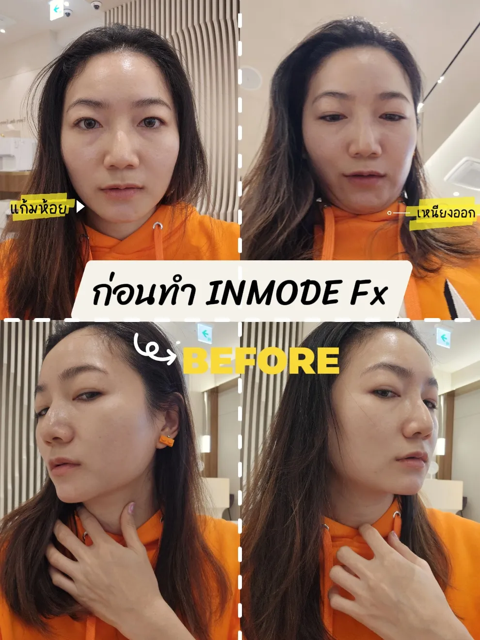 INMODE Fx ที่เกาหลี🇰🇷 ไม่ถึง 2 ใบเทา | แกลเลอรีที่โพสต์โดย Pearllii🐚🔮 | Lemon8