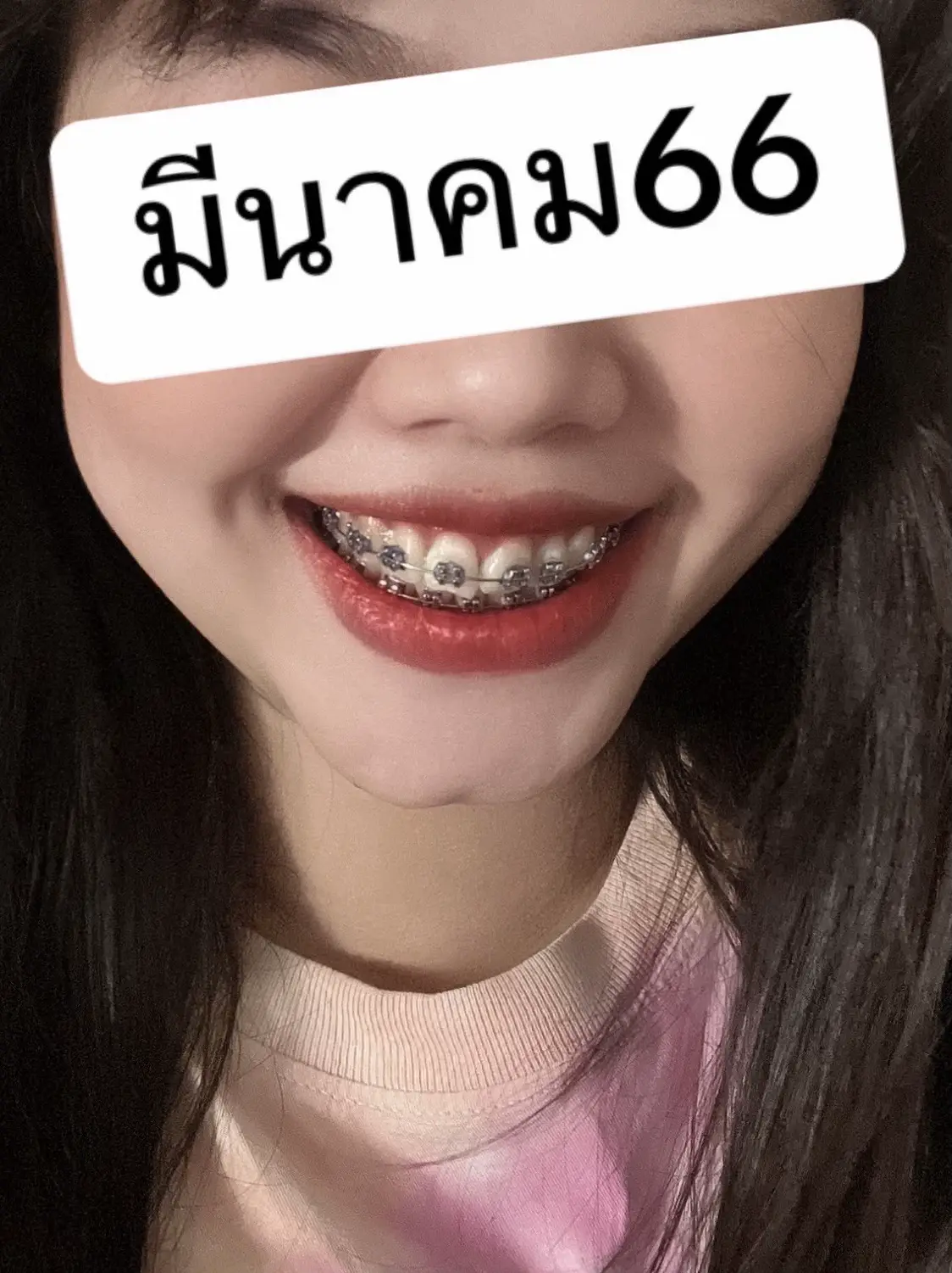 รีวิวจัดฟัน @ศาลายา นครปฐม | แกลเลอรีที่โพสต์โดย Thitikarn Boo | Lemon8