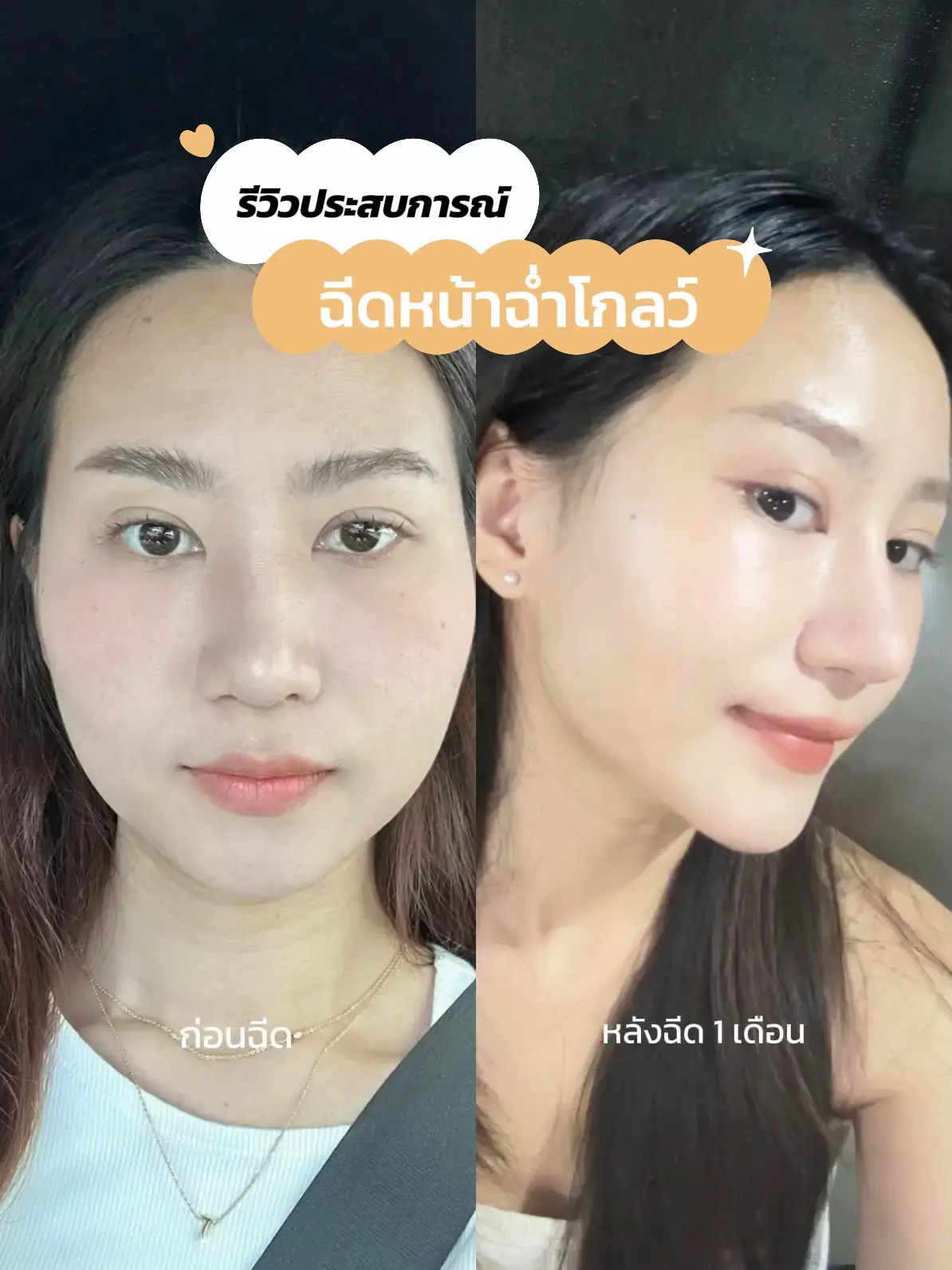 แชร์ประสบการณ์💉 ฉีดหน้าฉ่ำโกลว์ เห็นผลเร็วมาก | แกลเลอรีที่โพสต์โดย Bai por | Lemon8