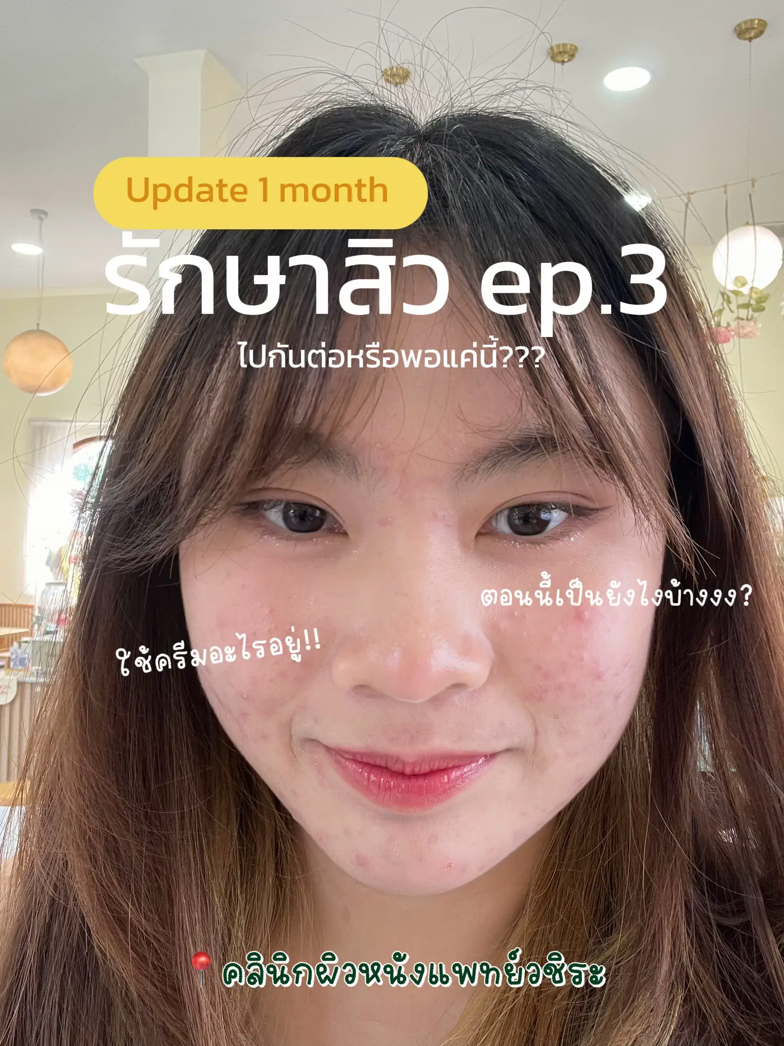 EP.3 อัพเดตรักษาสิวที่คลินิกแพทย์ผิวหนังวชิระ | แกลเลอรีที่โพสต์โดย Earn.jrp⭐️ | Lemon8