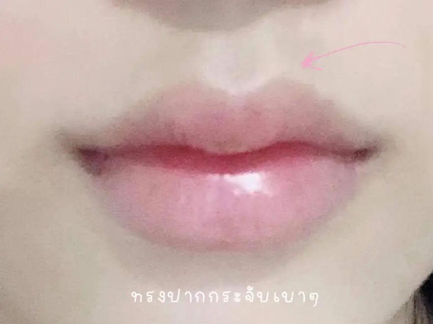 รีวิวตัดปาก กับหมออันดับ1 ของไทย👄 | แกลเลอรีที่โพสต์โดย Orm aam | Lemon8