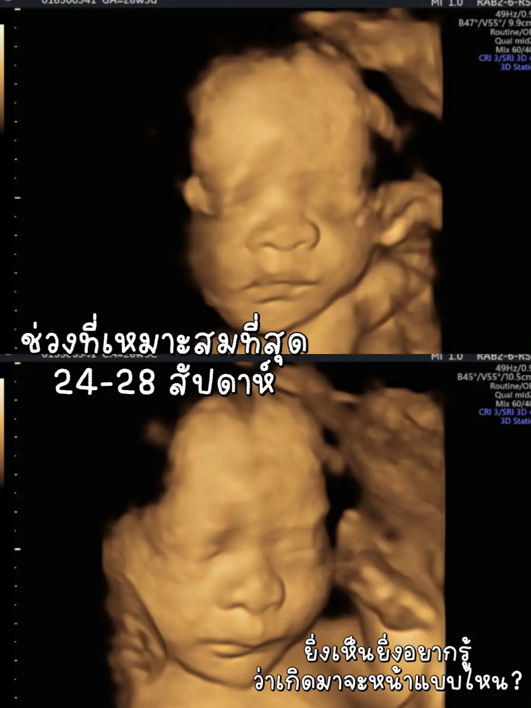 Q&A - 4D Scan ควรทำช่วงไหน ตรงปกไหมนะ? | แกลเลอรีที่โพสต์โดย Stardust 💫 ...