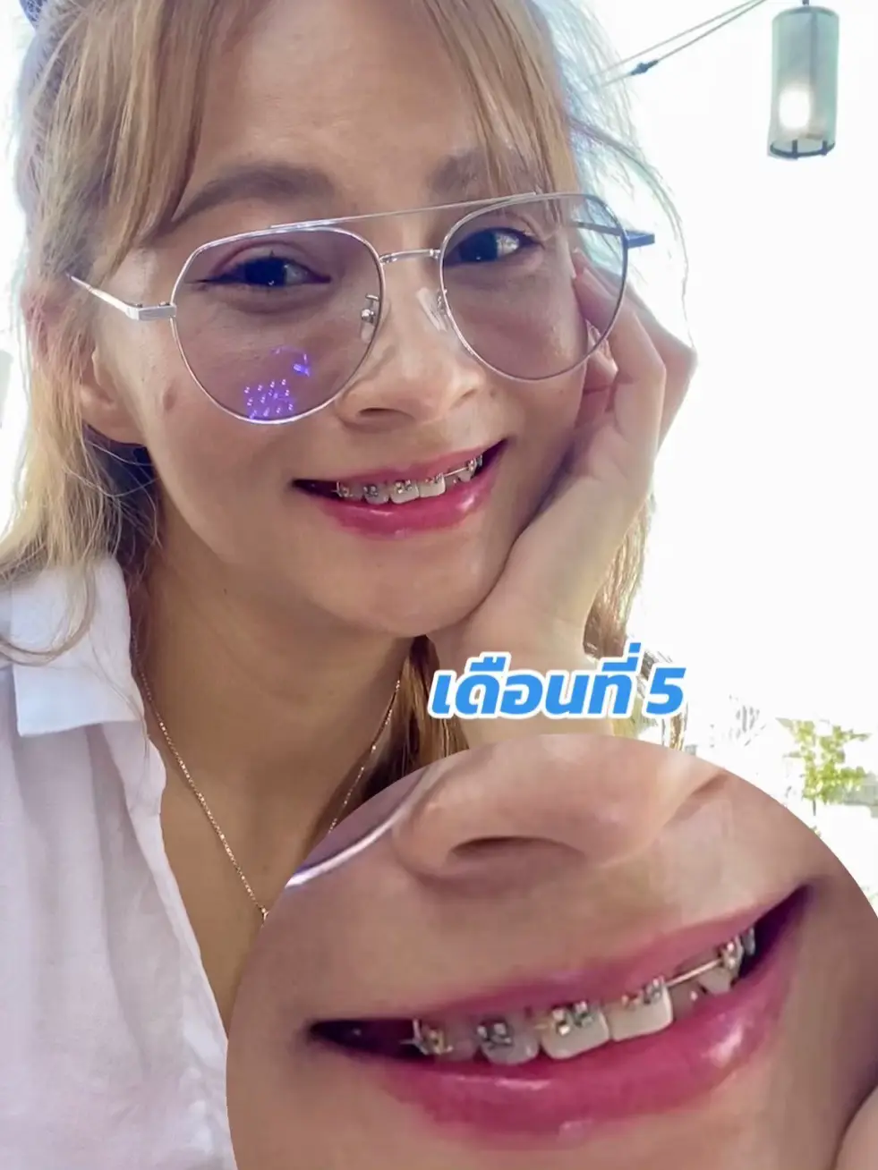 รีวิวจัดฟัน ในวัยเลข4 | แกลเลอรีที่โพสต์โดย Goonggiヅ กุ้งกิ | Lemon8