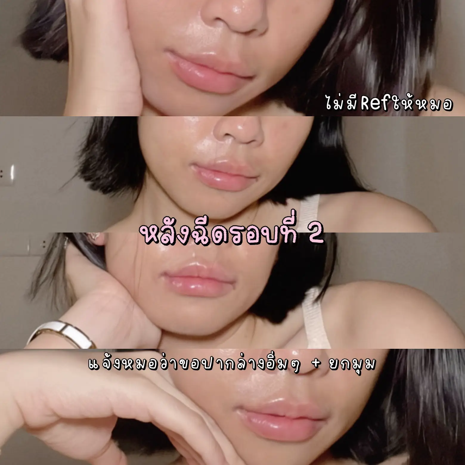 ฟิลเลอร์ปากทั้ง 2 รอบ ที่ธรรมดาคลินิก | แกลเลอรีที่โพสต์โดย toffy 🍬🍭 | Lemon8