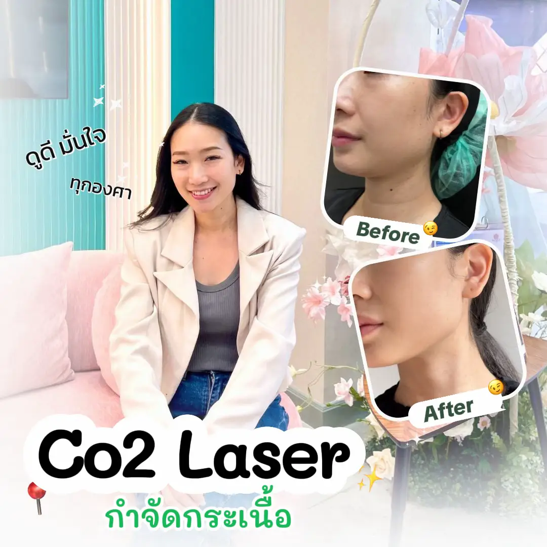 Co2 Laser กำจัดติ้งเนื้อ ไฝ ขี้แมลงวัน | แกลเลอรีที่โพสต์โดย Pruksa Clinic | Lemon8