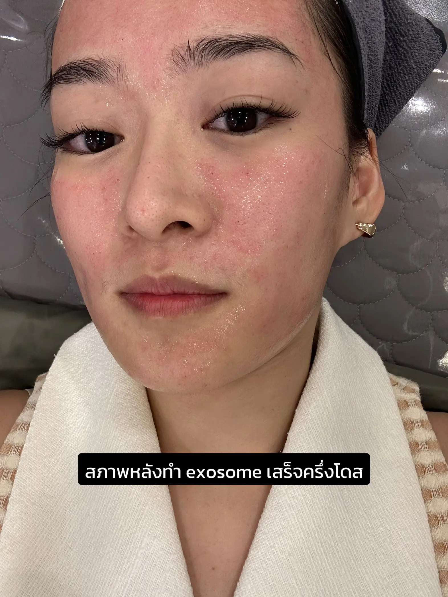 รีวิวฉีด exosome ที่เกาหลี Muse clinic แค่ 5,xxx บาท | แกลเลอรีที่โพสต์โดย noon💫 | Lemon8