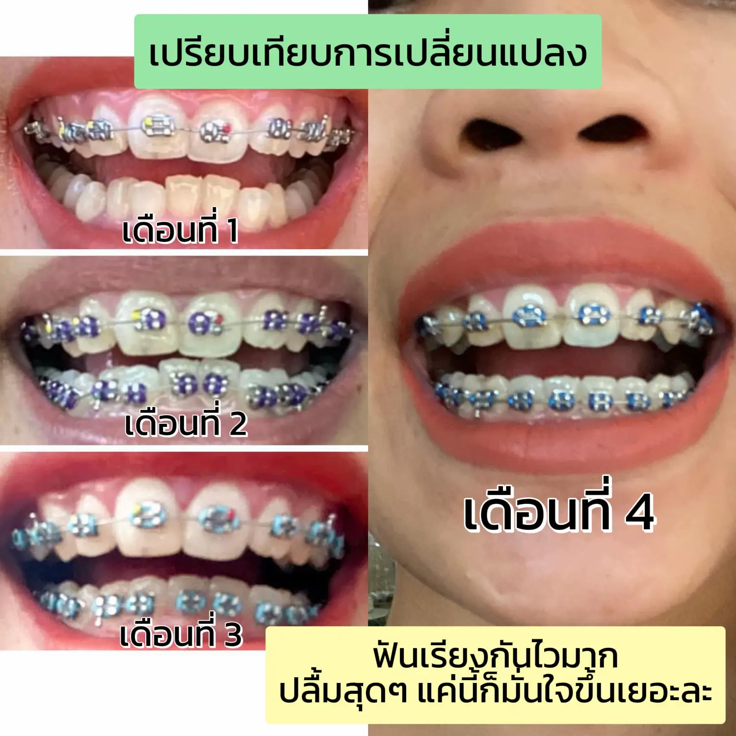 จัดฟันครบ 1 ปีแล้ว มีอะไรเปลี่ยนไปบ้าง? | แกลเลอรีที่โพสต์โดย Ratchaporn Sinm | Lemon8