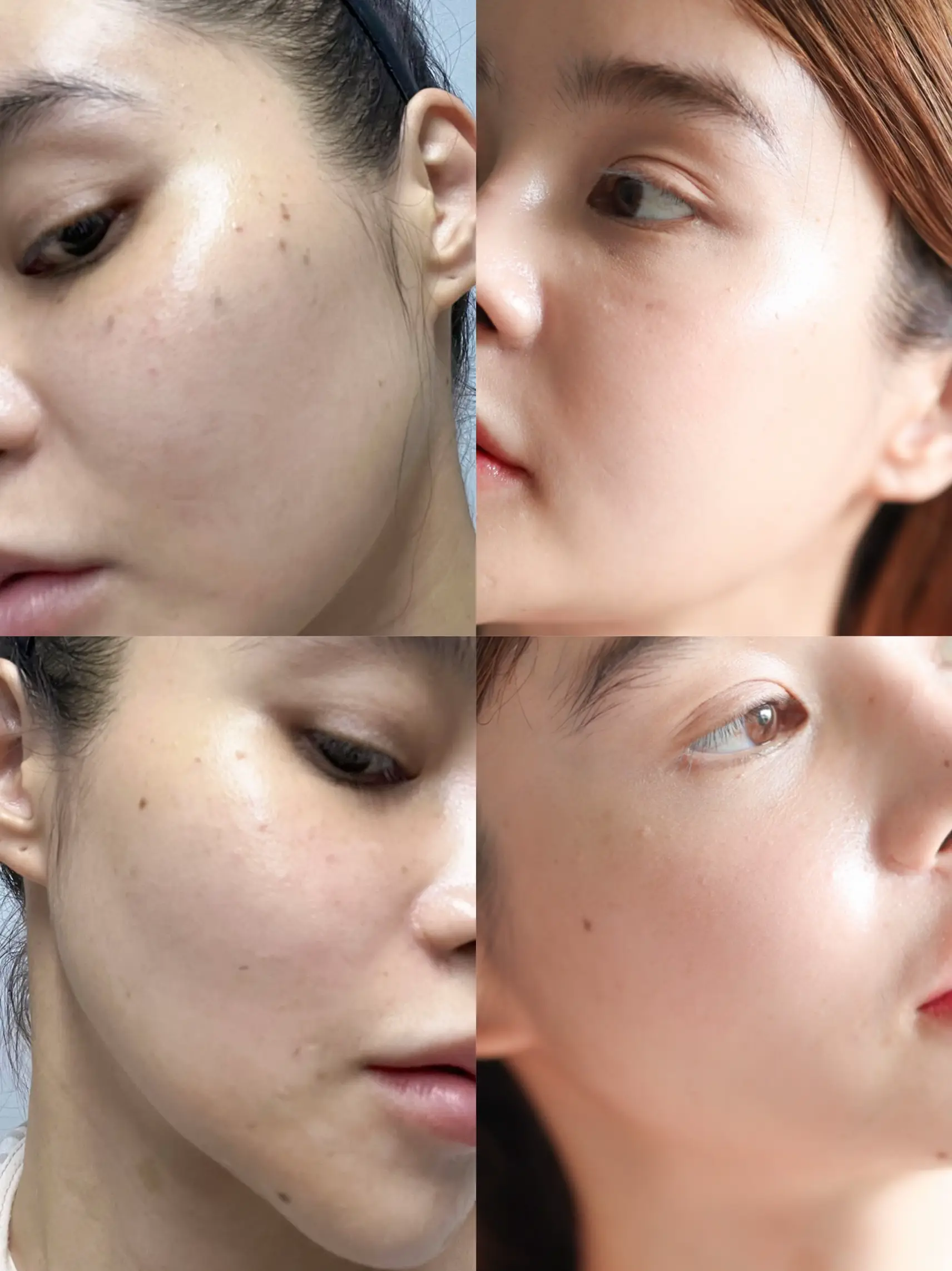 💜BYE BYE MELASMA ตัวช่วยดีดีของคนเป็นฝ้า !! | แกลเลอรีที่โพสต์โดย May’s ...