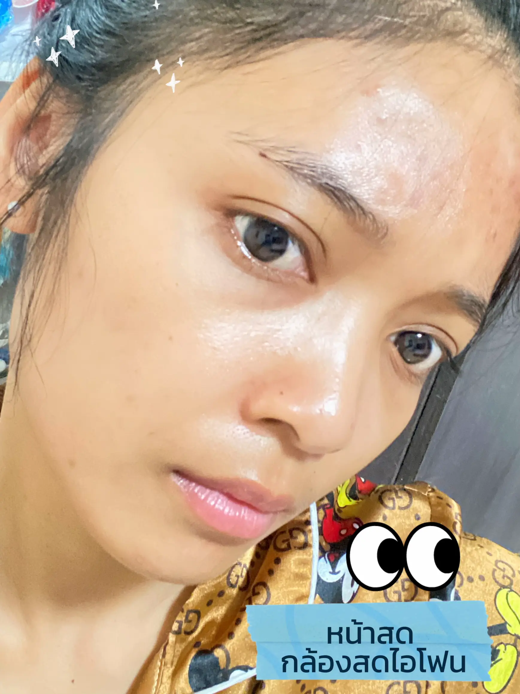 สกิลแคร์รักษาสิวงบหลักร้อย | แกลเลอรีที่โพสต์โดย Mod_luckkana