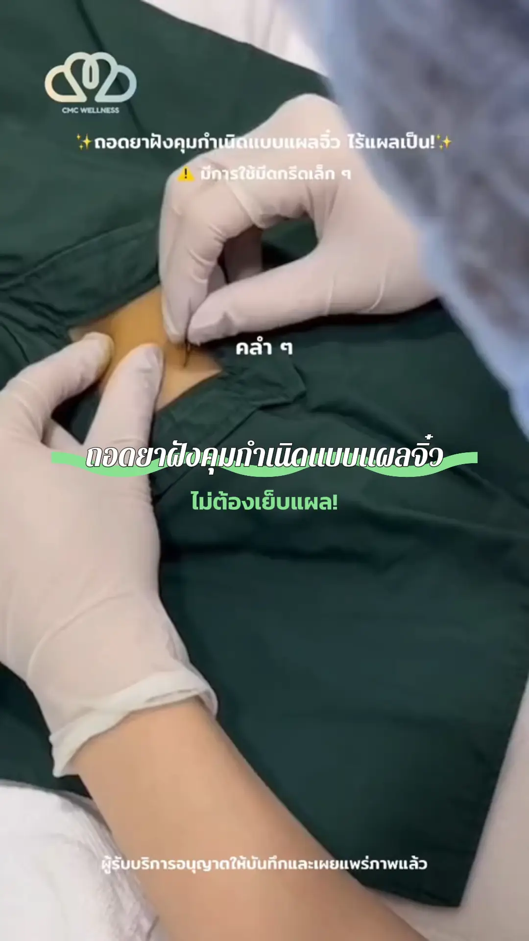 รีวิวถอดยาฝังคุมกำเนิด แผลจิ๋ว ไม่เจ็บ ไม่ต้องเย็บแผล 🩺 | วิดีโอที่เผยแพร่โดย CMC Wellness | Lemon8