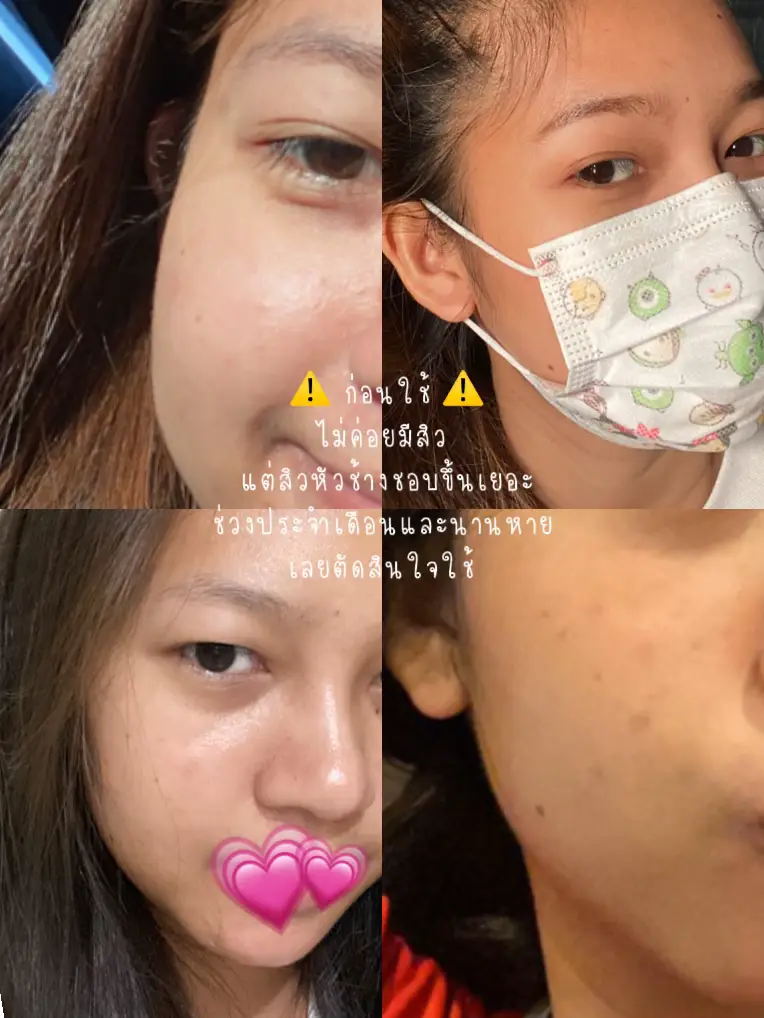 Acnetin a ปังหรือพัง?!! | แกลเลอรีที่โพสต์โดย Mintny | Lemon8