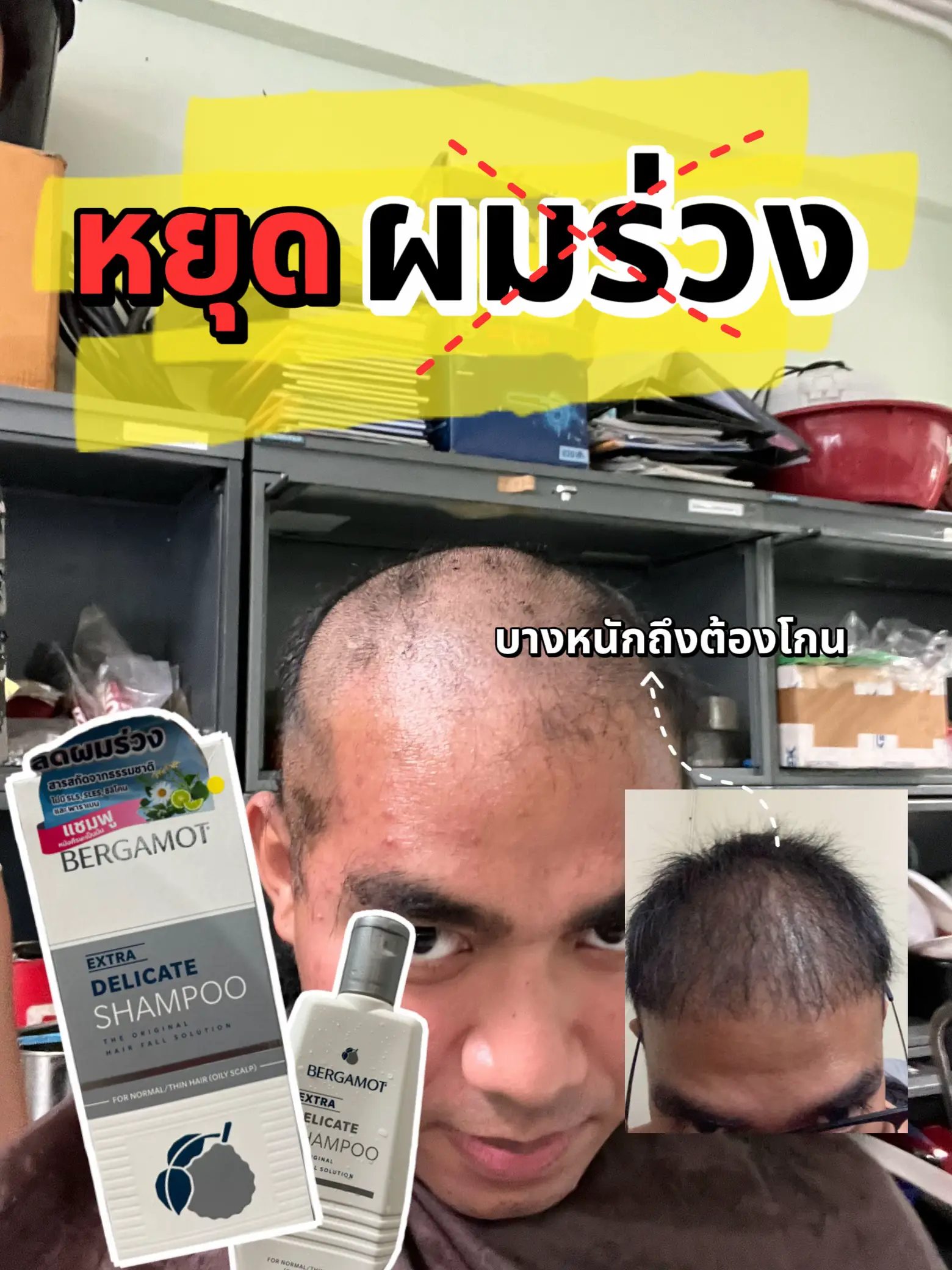 ปัญหาผมร่วง | แกลเลอรีที่โพสต์โดย Machingun | Lemon8